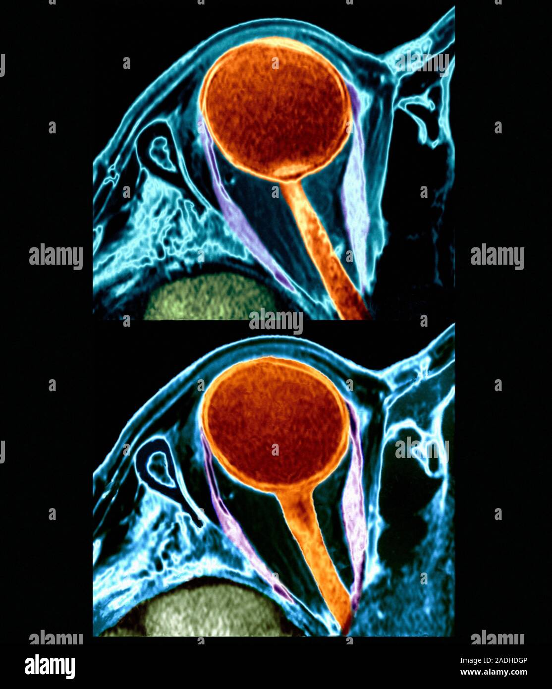 Eye cancer. Coloured axial magnetic resonance imaging (MRI) scans ...