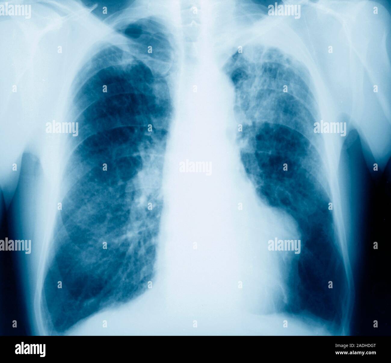 Lung cancer. Chest X-ray of a male patient showing evidence of a ...