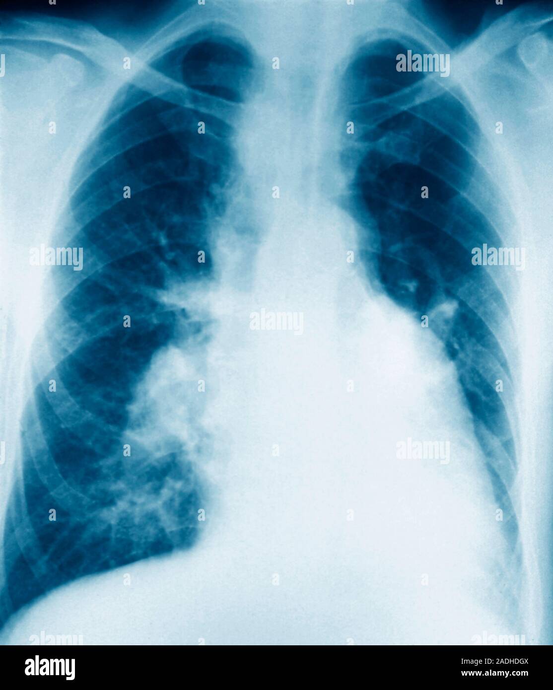 Oesophageal cancer. X-ray of the chest of a patient with cancer of the ...