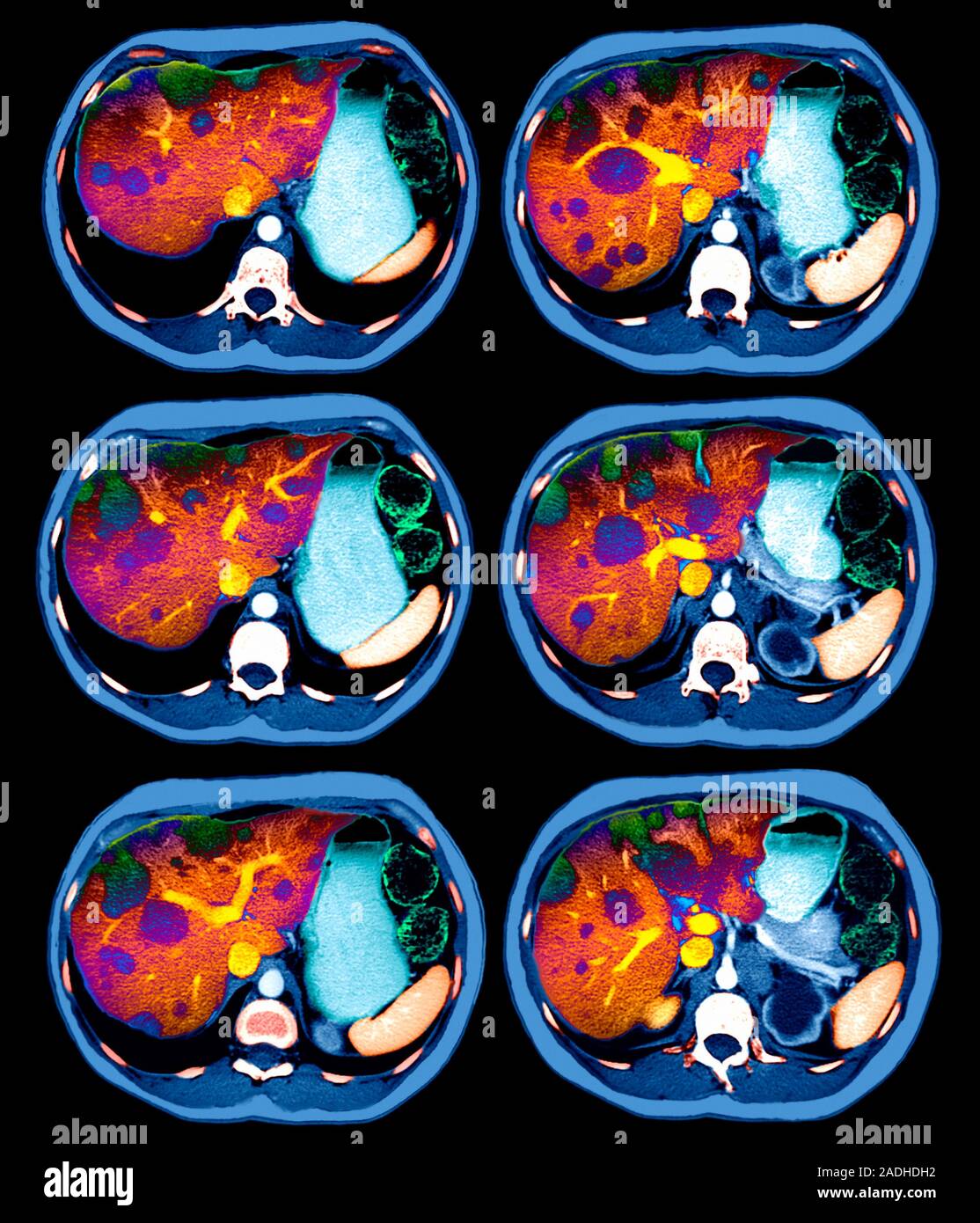 Liver cancer. Six computed tomography (CT) scans through a female ...