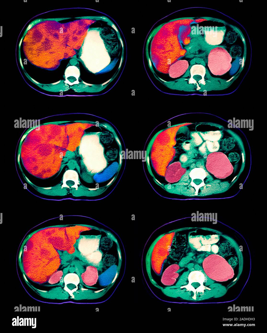 Liver cancer. Coloured computed tomography (CT) scans of sections through the body of a female ...