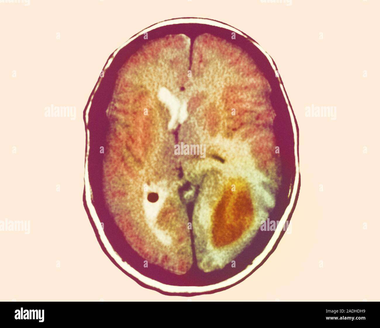 Glioma brain cancer. (Image 1 of 2) Coloured computed tomography (CT) scan in axial section ...