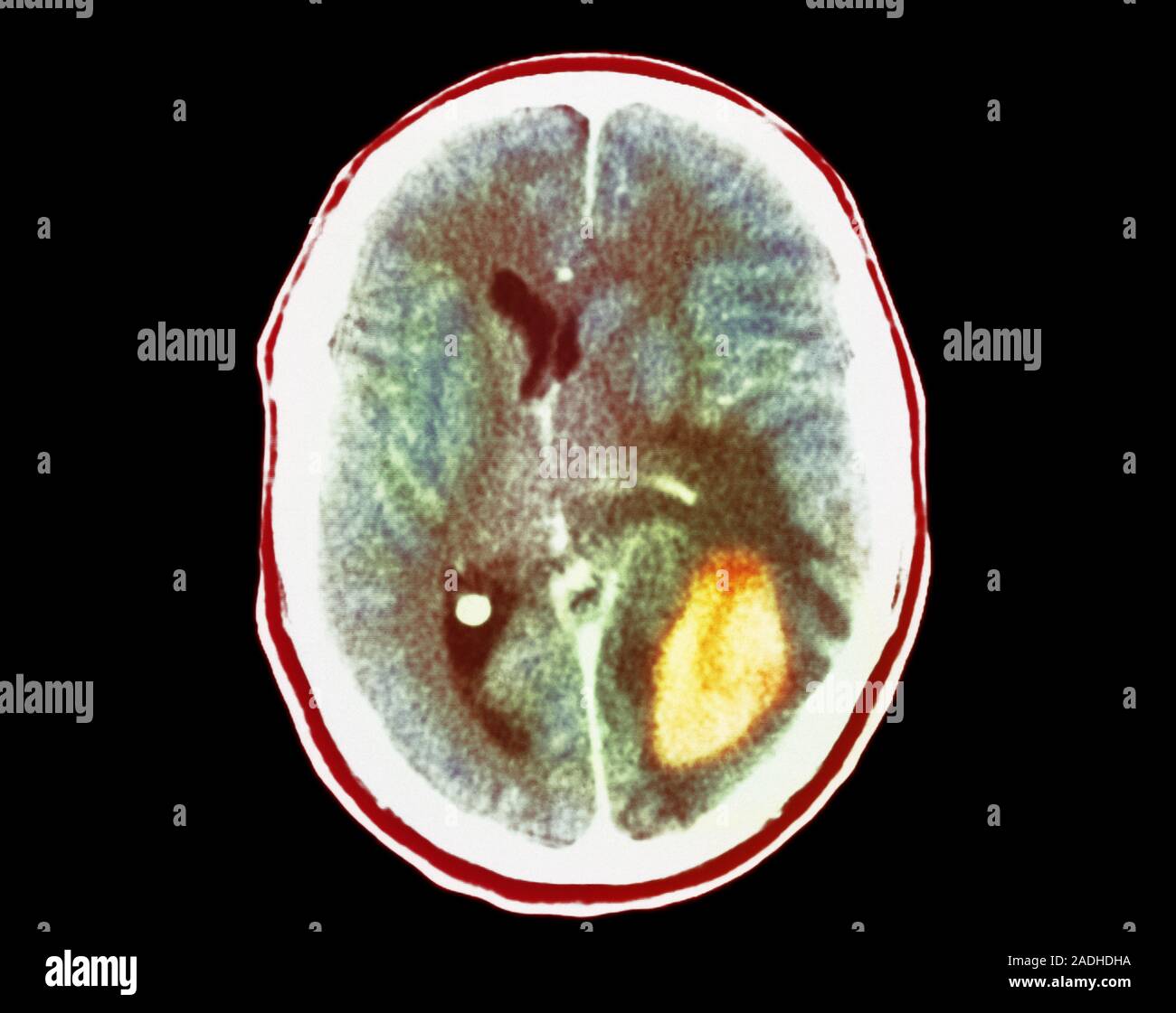Glioma brain cancer. (Image 1 of 2) Coloured computed tomography (CT ...