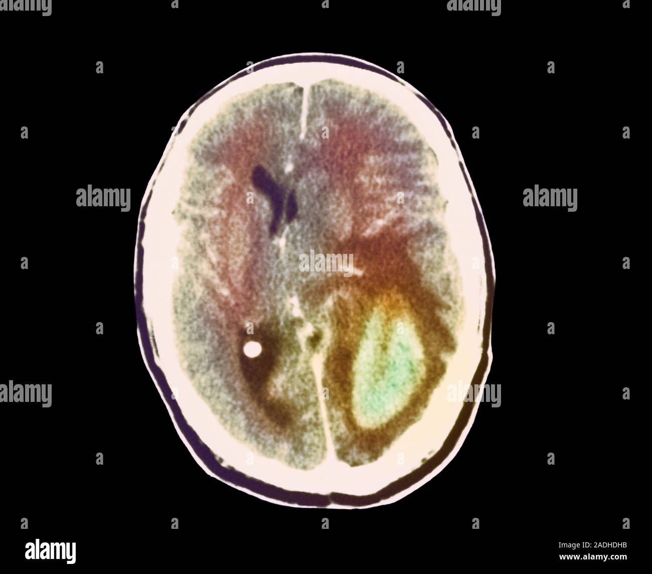 Brain cancer growth. (Image 2 of 2) Coloured computed tomography (CT) scan in axial section ...