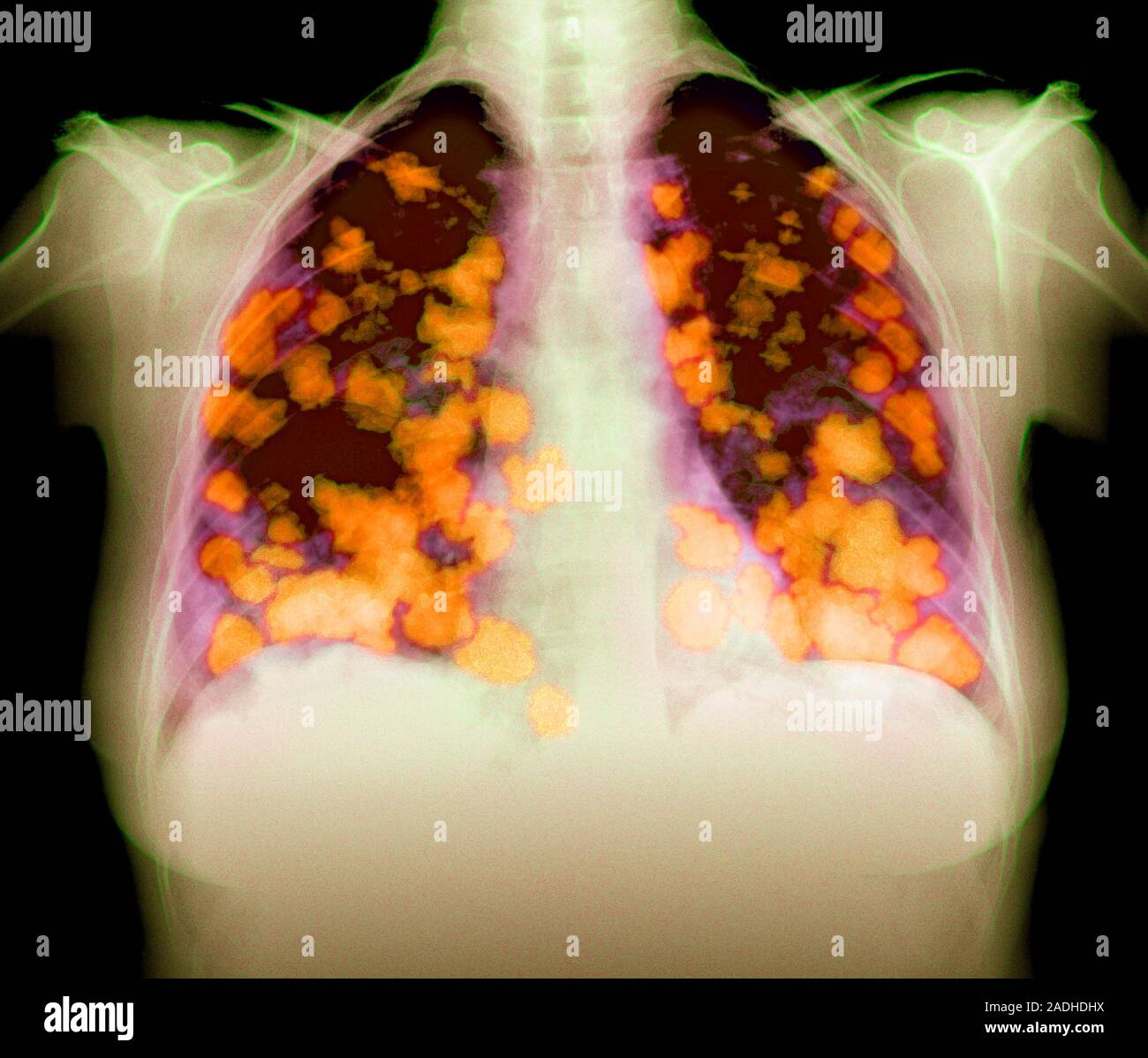Secondary lung cancers, coloured X-ray. Metastases (secondary cancers ...