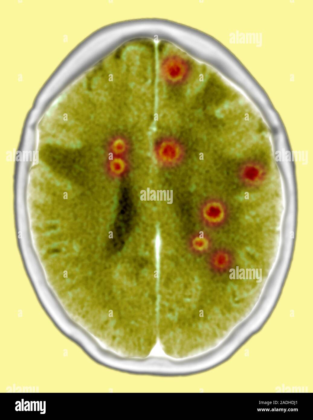 Secondary brain cancers. Coloured axial computed tomography (CT) scan through the head of a ...