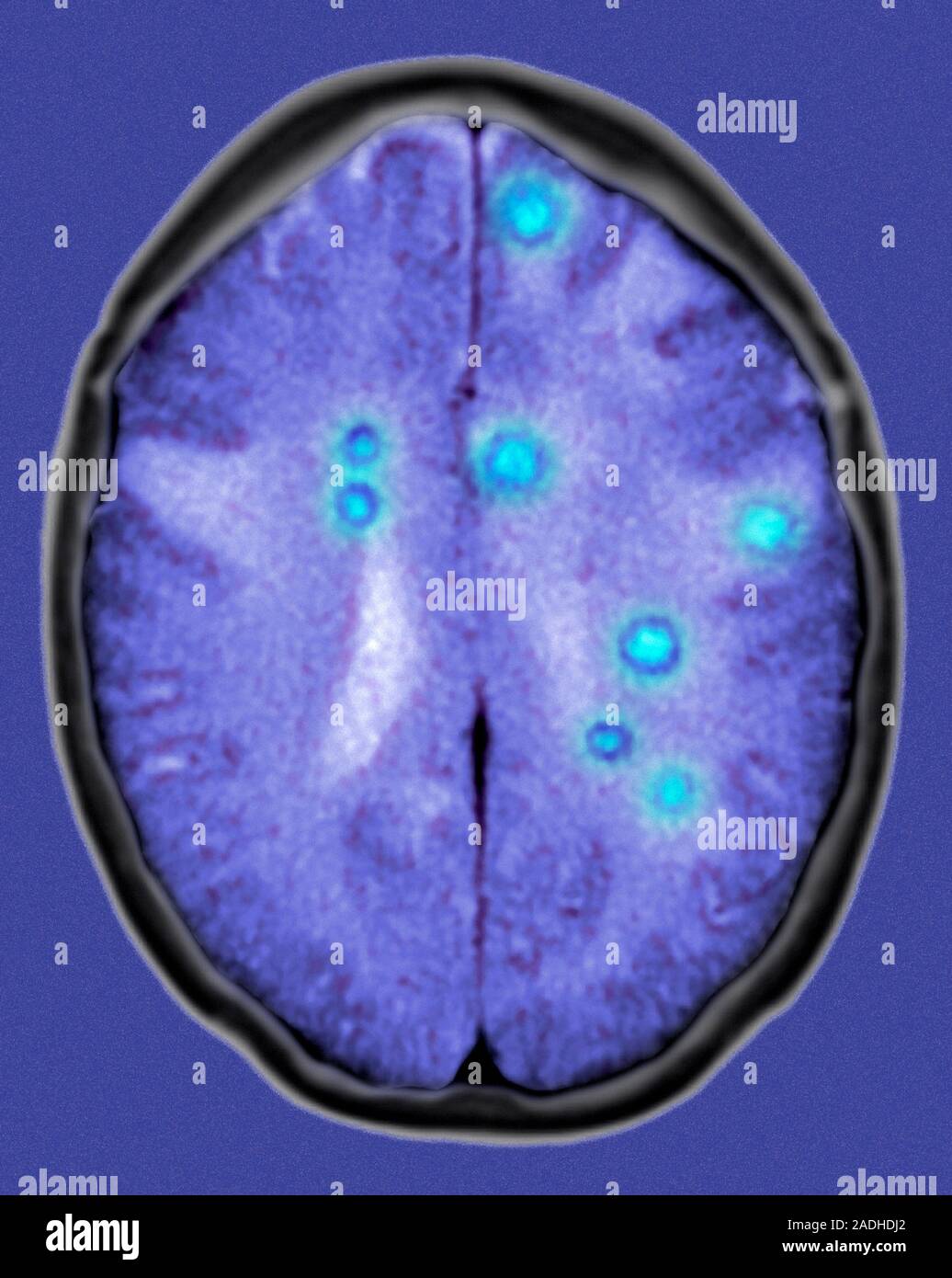 Secondary brain cancers. Coloured axial computed tomography (CT) scan through the head of a ...