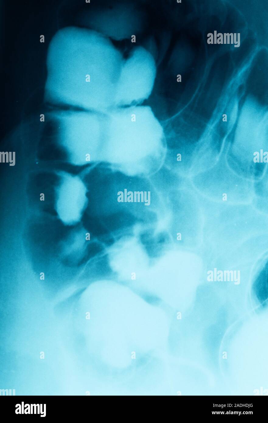 Colon cancer. Barium enema X-ray of the abdomen of a patient with ...