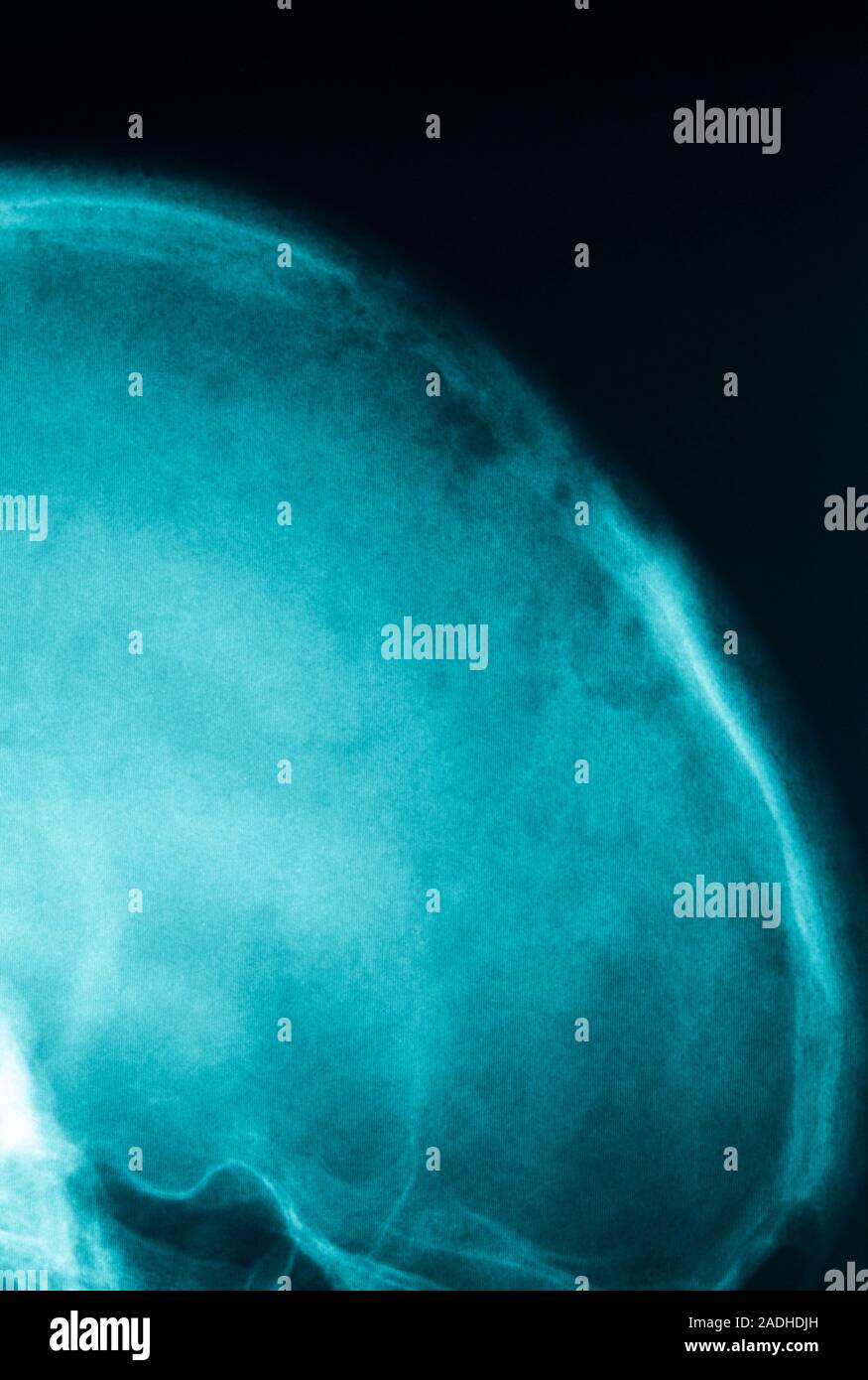 Secondary bone cancers. Side X-ray of the back of the skull of a ...