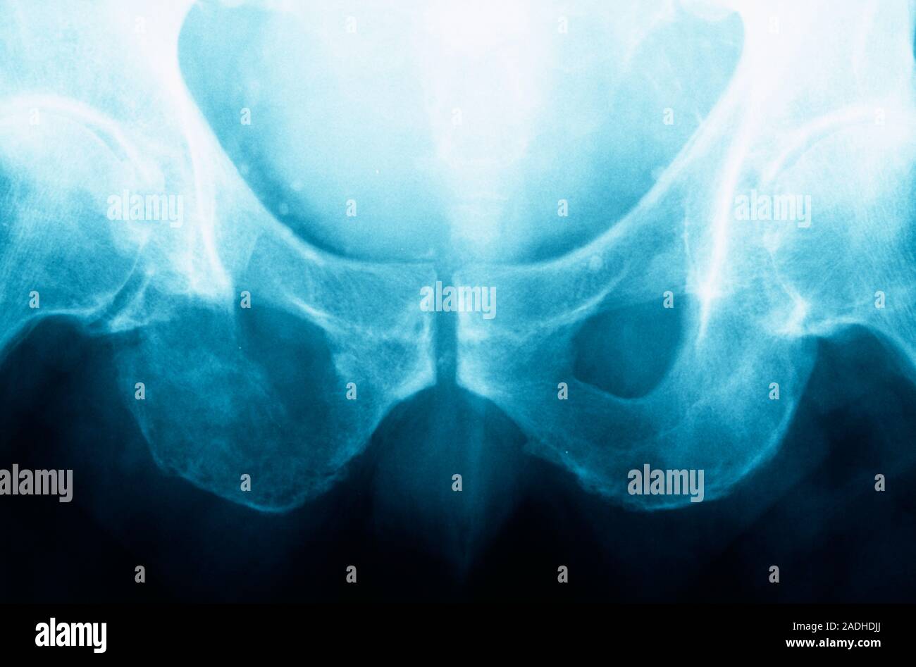 Secondary bone cancers. Frontal X-ray of the base of the pelvis in a ...