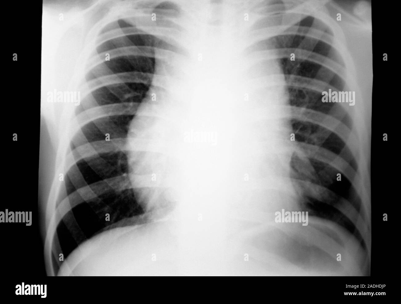 Hodgkin's disease, chest X-ray. Large growth (white) of Hodgkin's ...