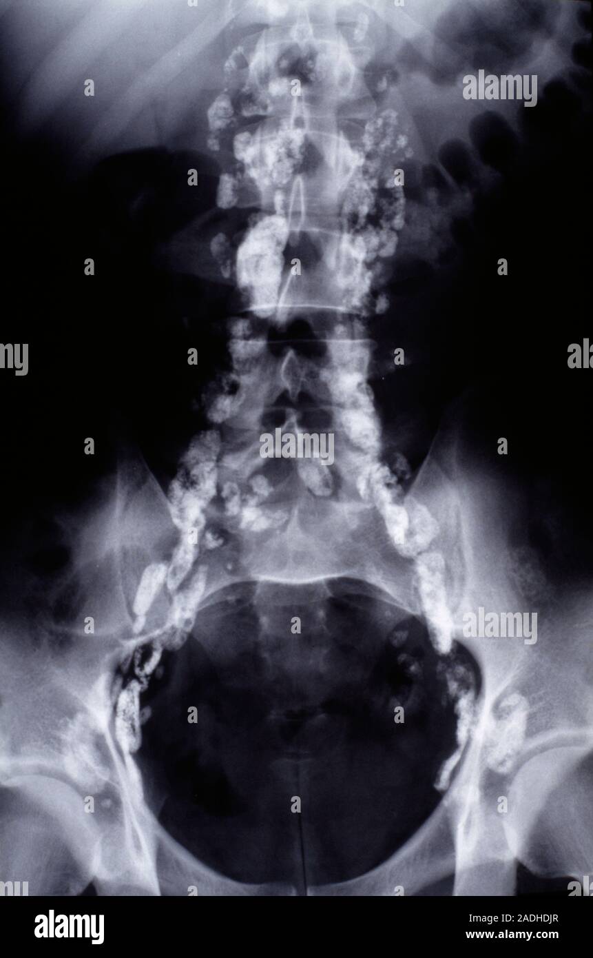 Hodgkin's disease. Abdominal lymphangiogram X-ray of a patient with ...