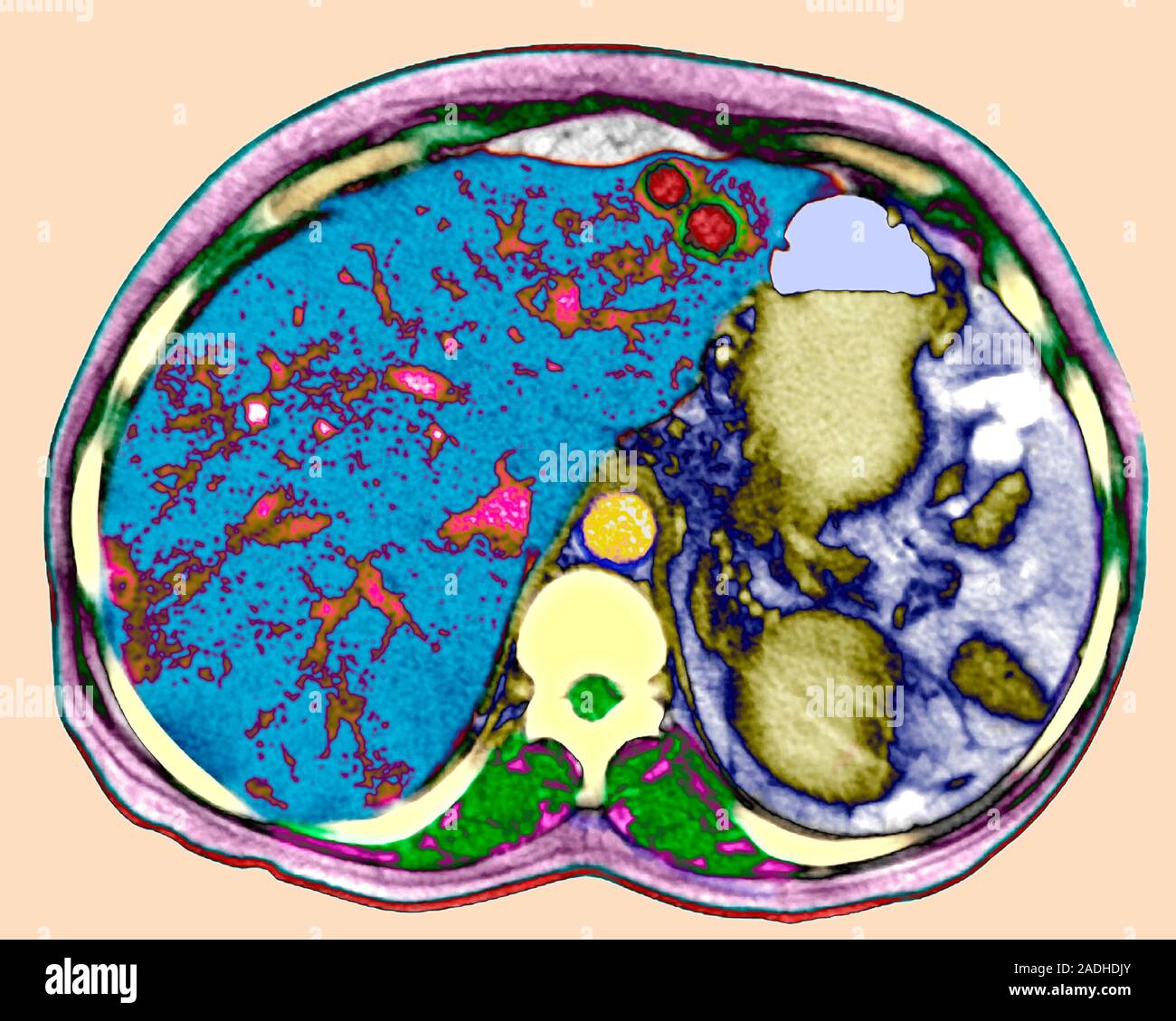 Secondary liver cancer. Coloured axial computed tomography (CT) scan ... Secondary liver cancer. Coloured axial computed tomography (CT) scan ...