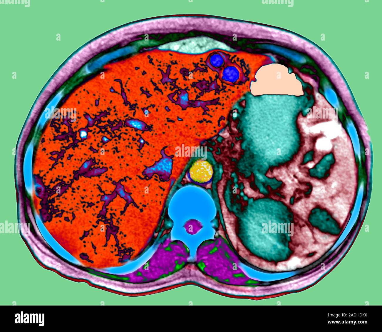 Secondary liver cancer. Coloured axial computed tomography (CT) scan ... Secondary liver cancer. Coloured axial computed tomography (CT) scan ...