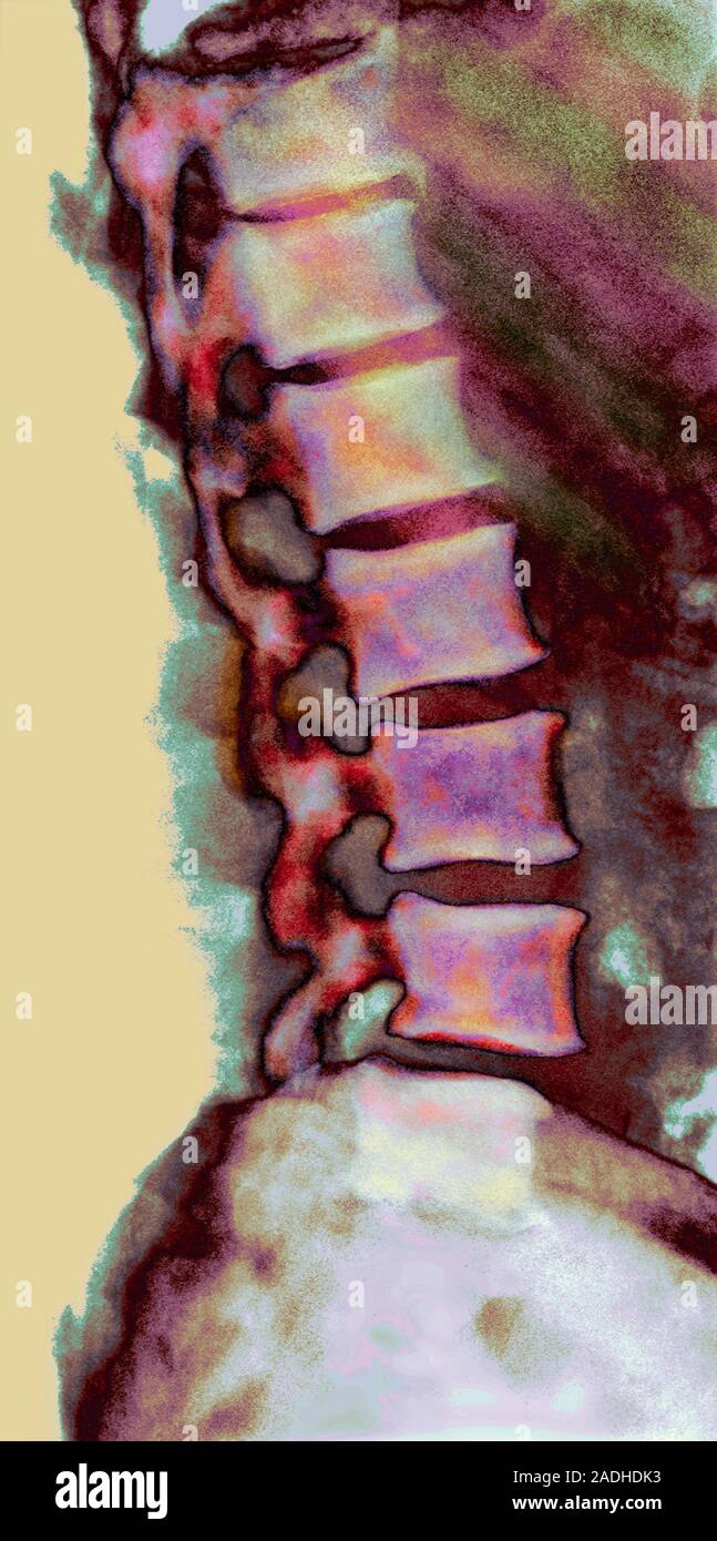 Secondary bone cancer. Coloured X-ray of a side view of the spine of a ...