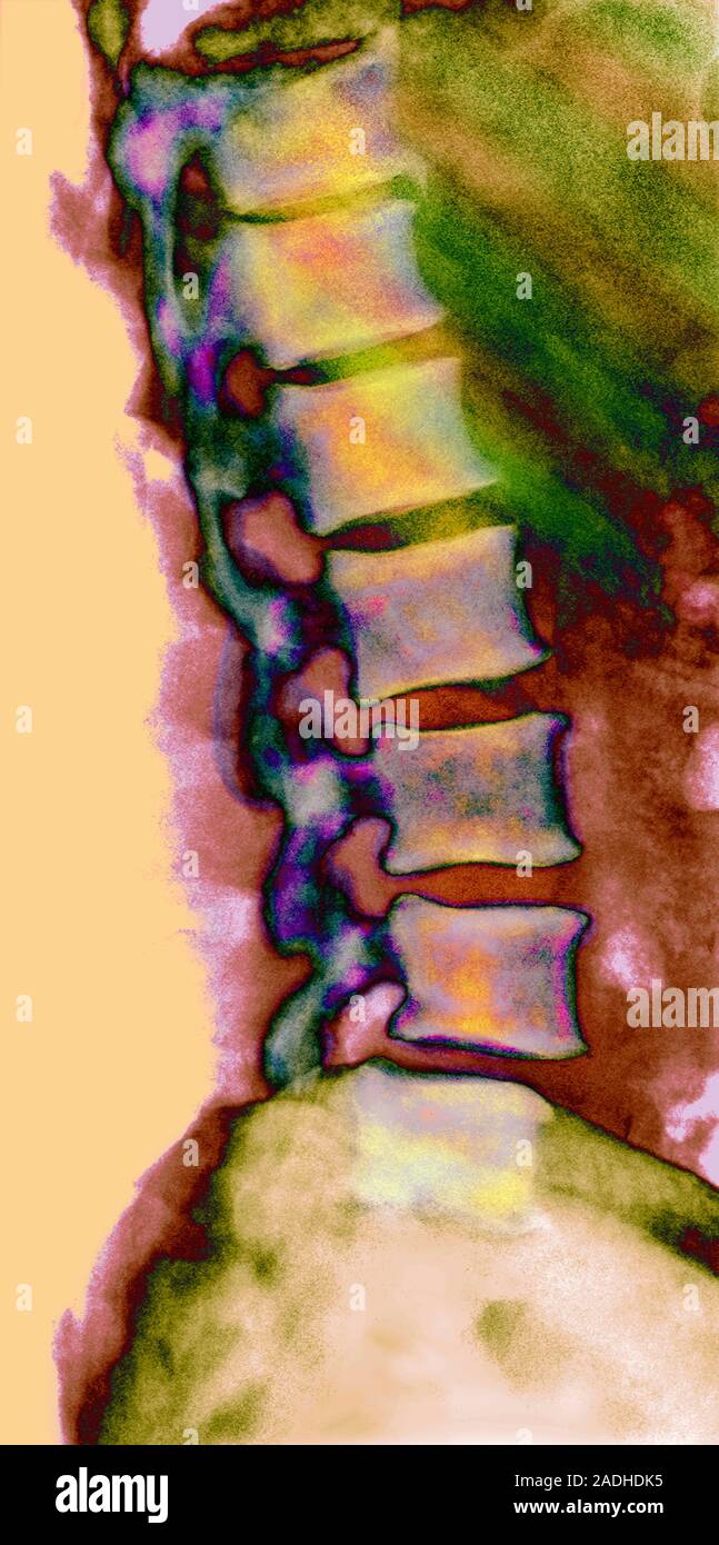 Secondary bone cancer. Coloured X-ray of a side view of the spine of a ...