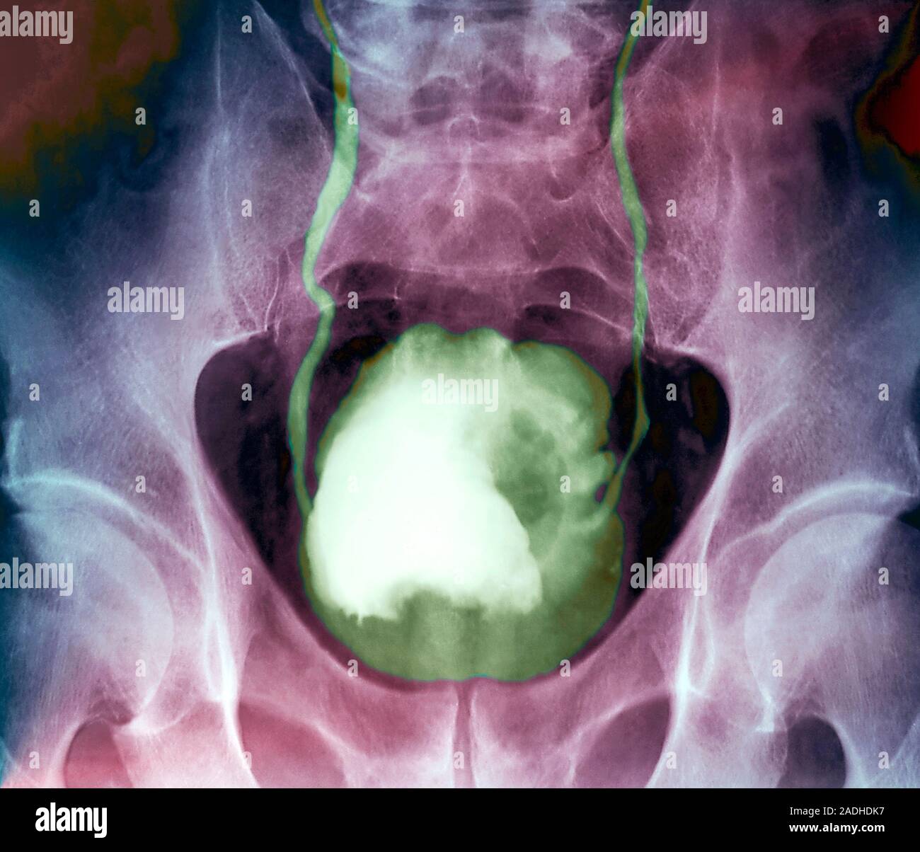 Bladder cancer. Coloured X-ray of a large cancerous tumour (white) in a ...