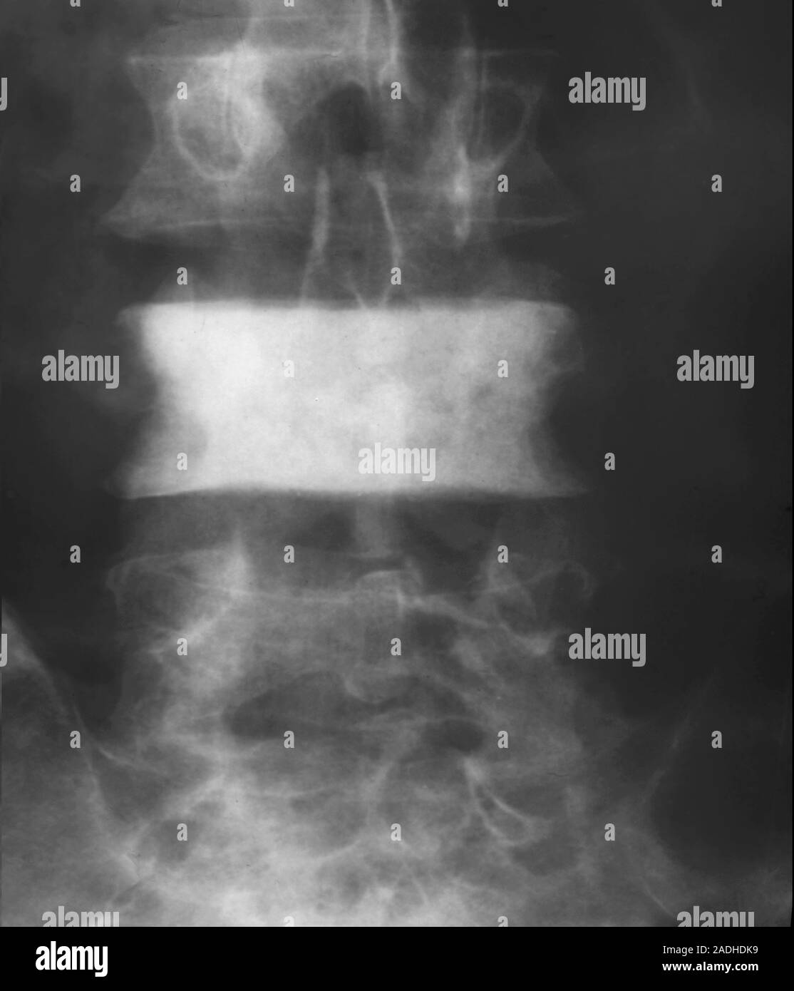 Secondary bone cancer. X-ray of a male patient with metastatic ...