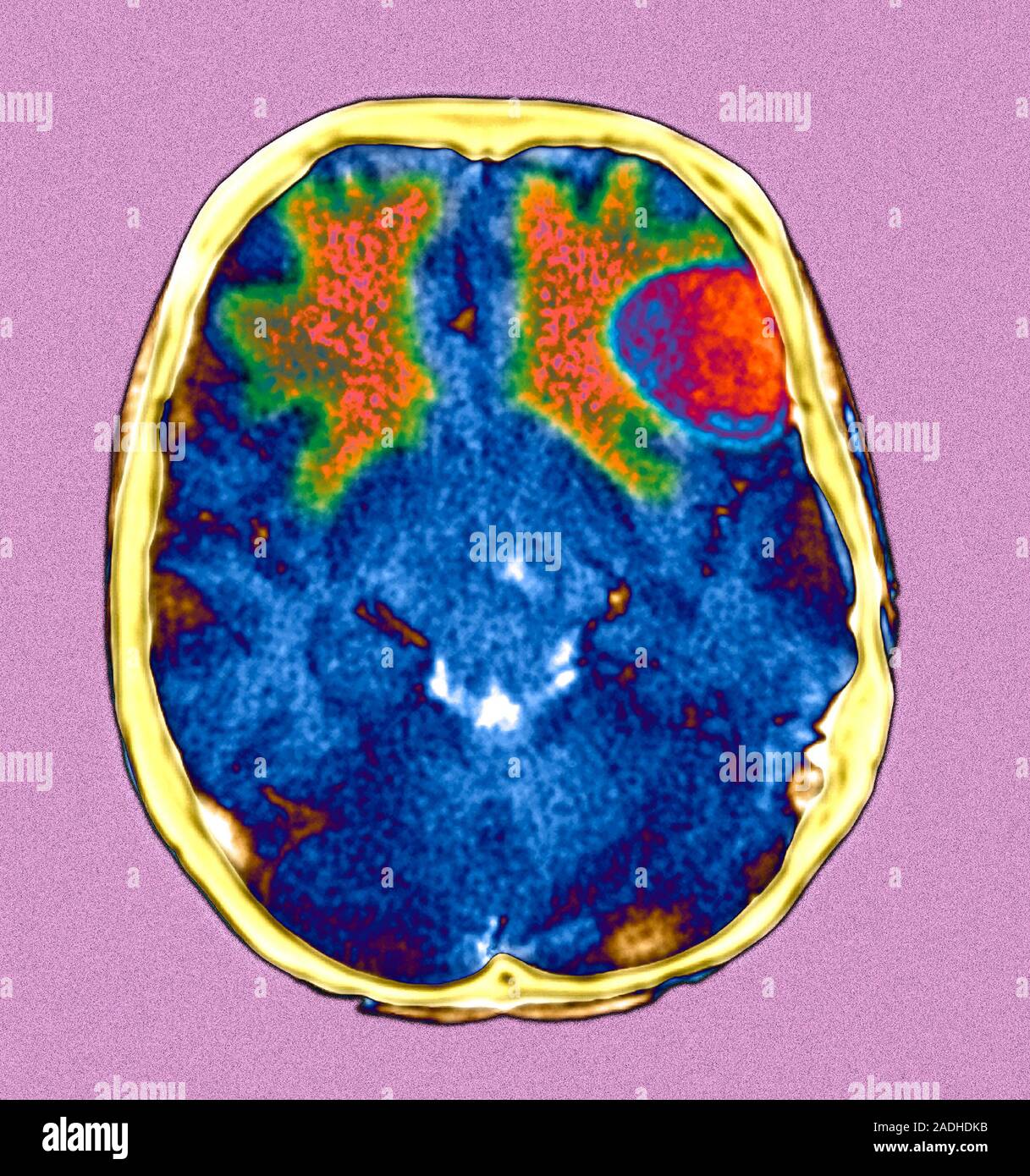 Secondary brain cancers. Image 2 of 4. Coloured computed tomography (CT) scan passing ...
