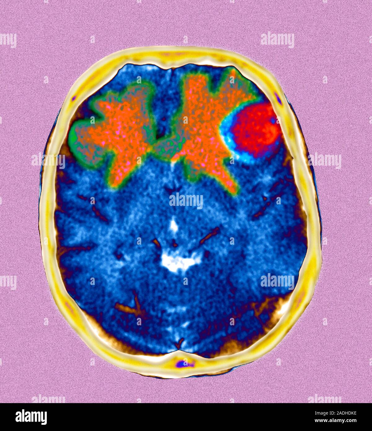Secondary brain cancers. Image 3 of 4. Coloured computed tomography (CT) scan passing ...