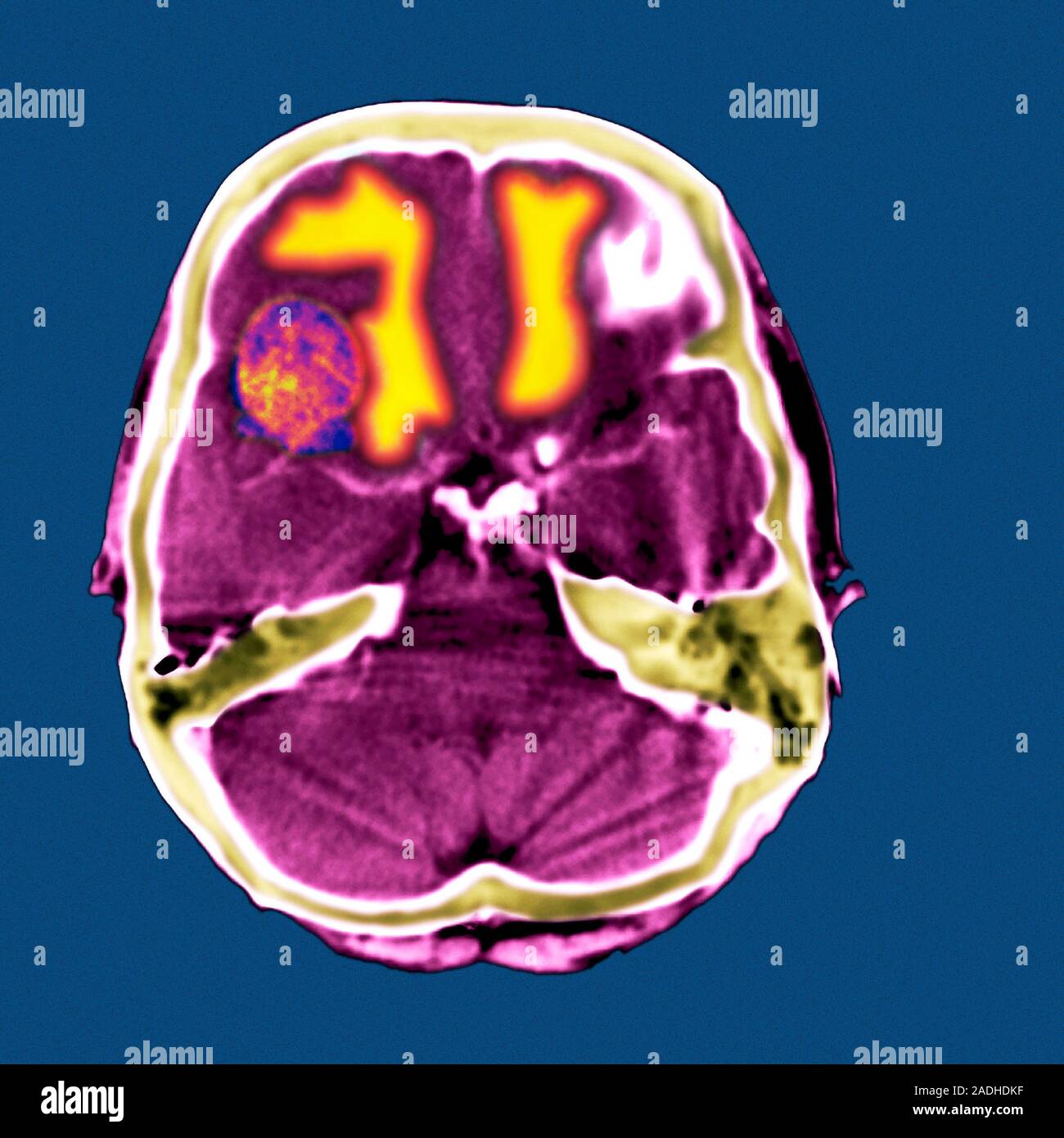 Secondary brain cancers. Image 1 of 4. Coloured computed tomography (CT) scan passing ...