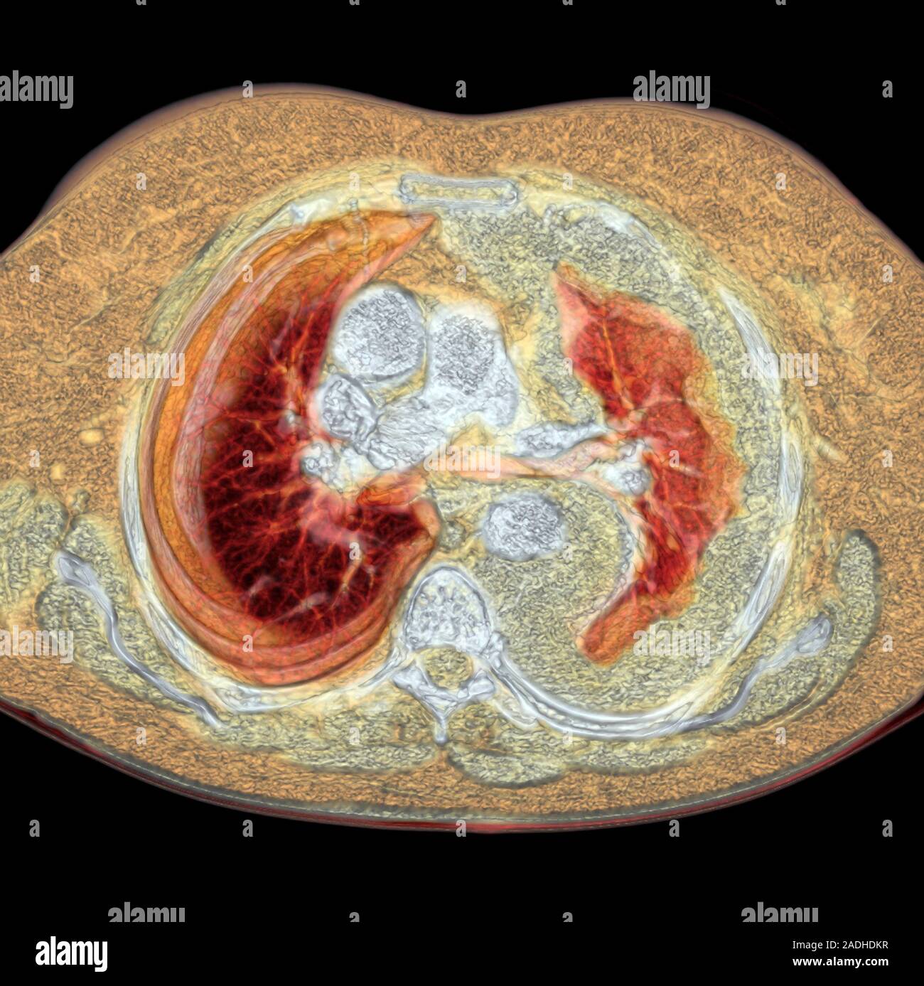 Lung cancer. Coloured computed tomography (CT) scan of an axial section ...