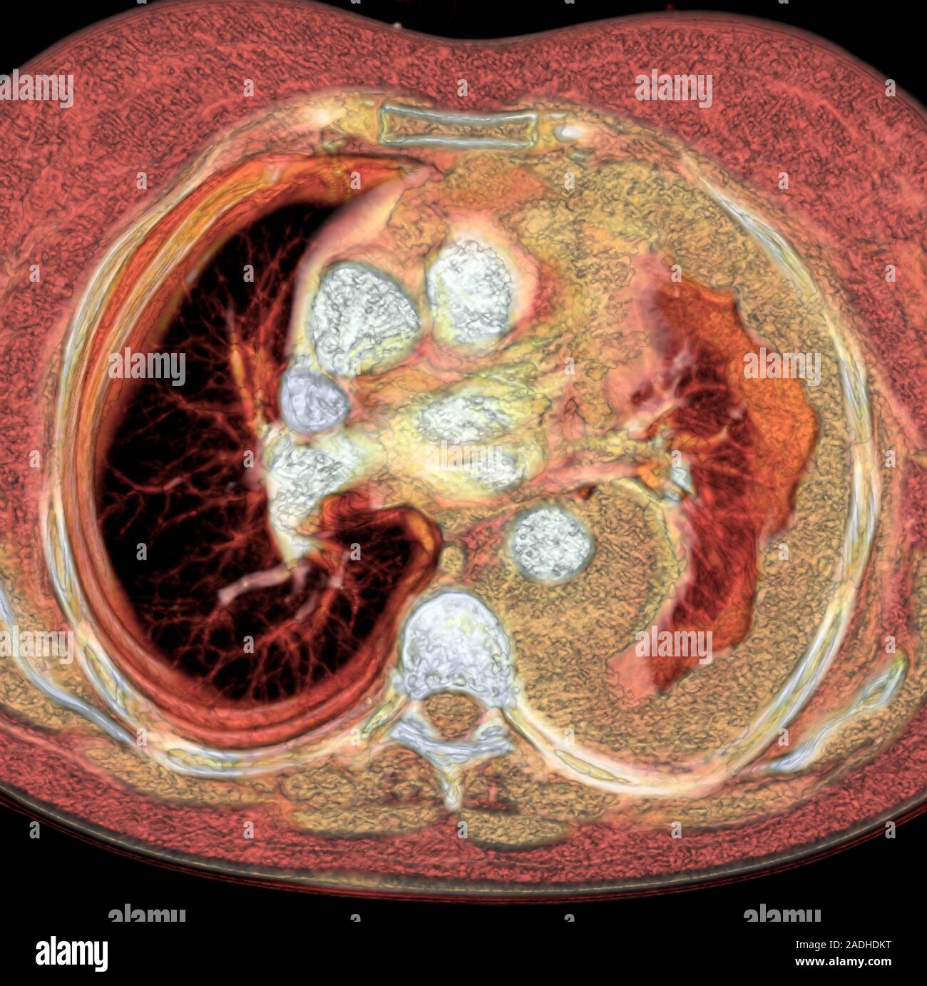 Lung cancer. Coloured computed tomography (CT) scan of an axial section ... Lung cancer. Coloured computed tomography (CT) scan of an axial section ...