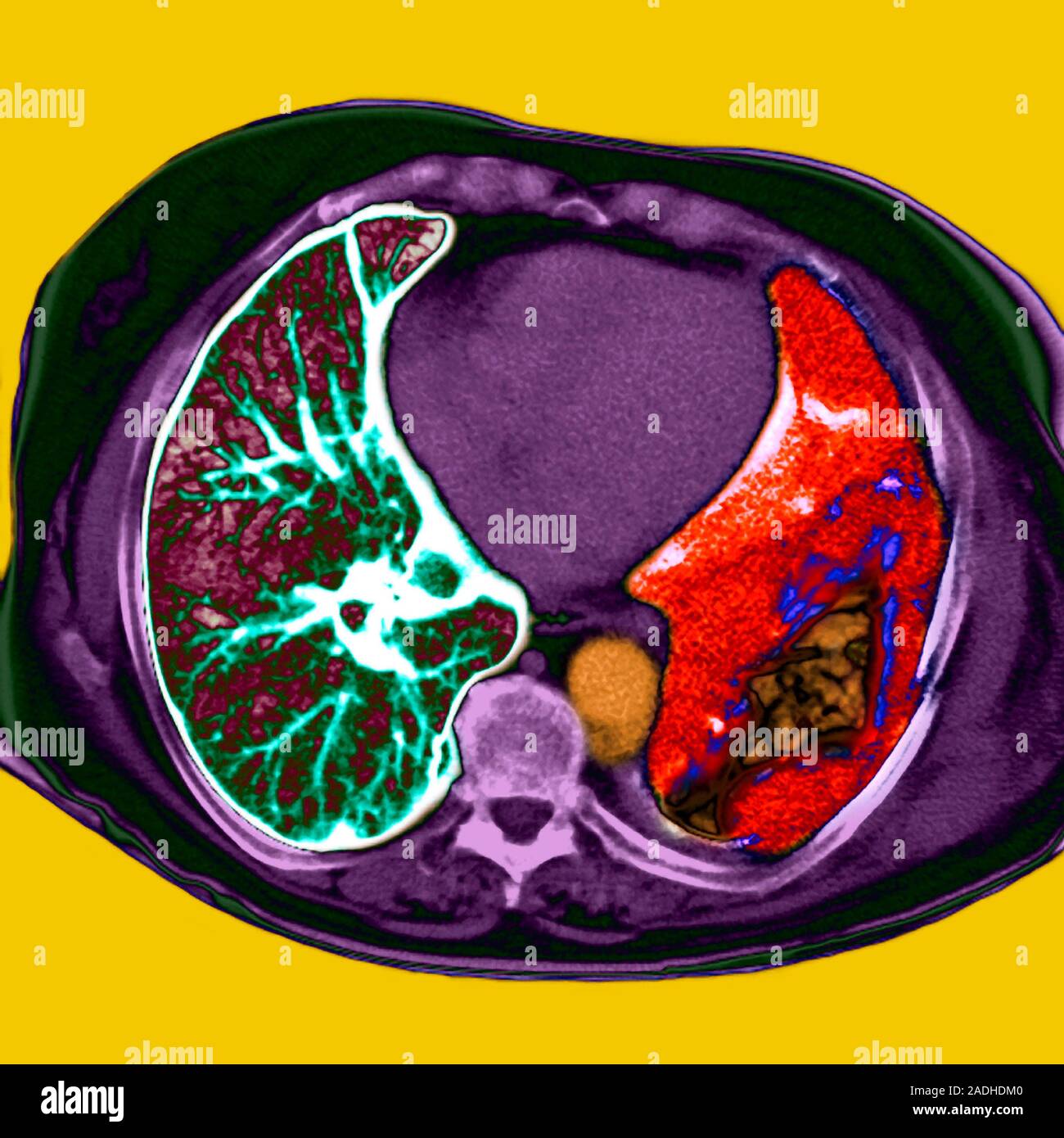 Lung cancer. Coloured computed tomography (CT) scan of an axial section through the chest of a ...