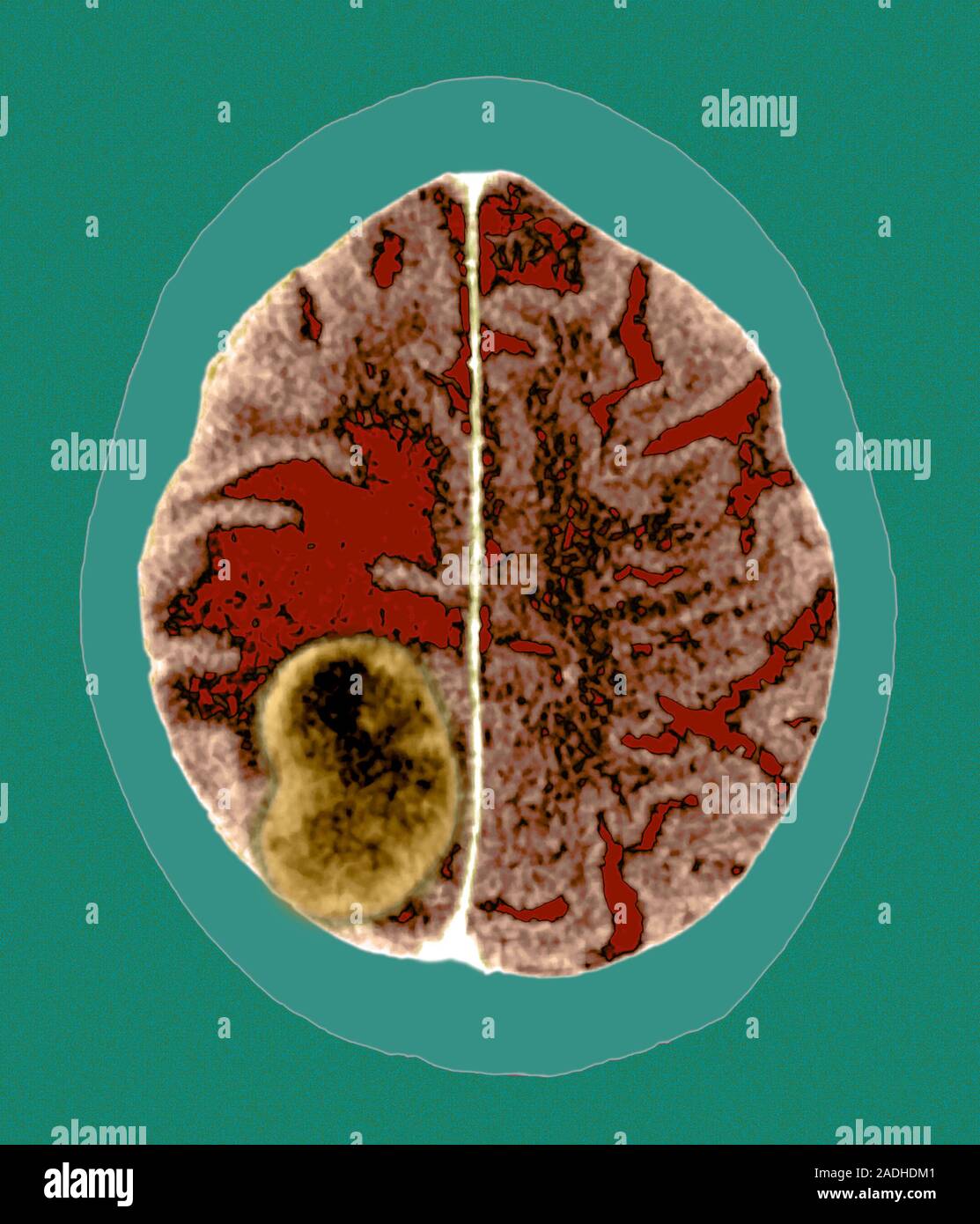 Secondary brain cancer. Coloured computed tomography (CT) scan passing ...