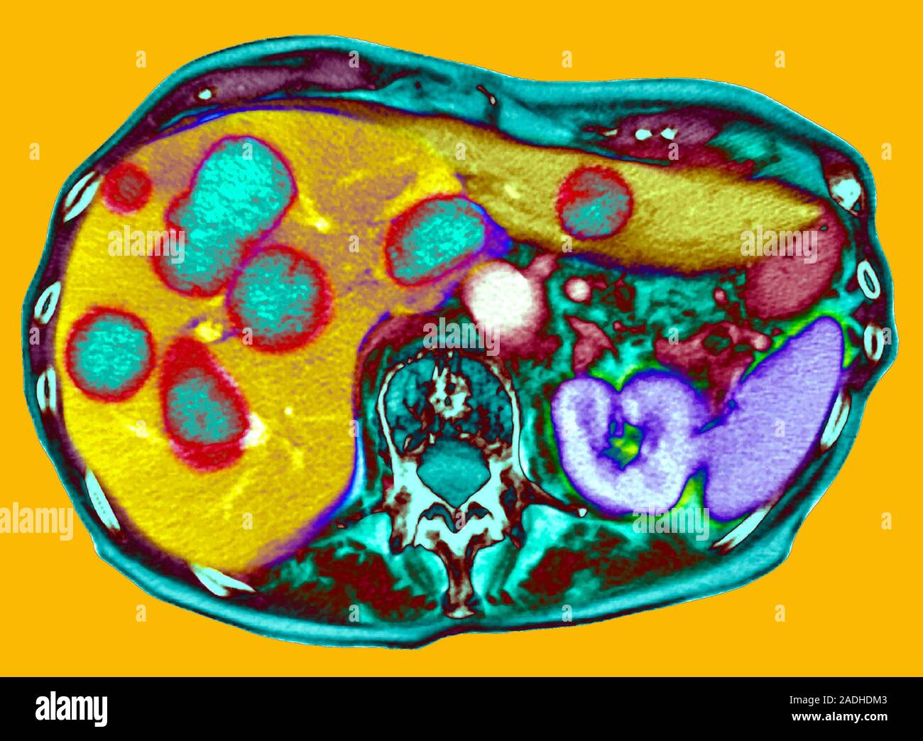 Secondary liver cancer. Coloured computed tomography (CT) scan of numerous tumours (light blue ...