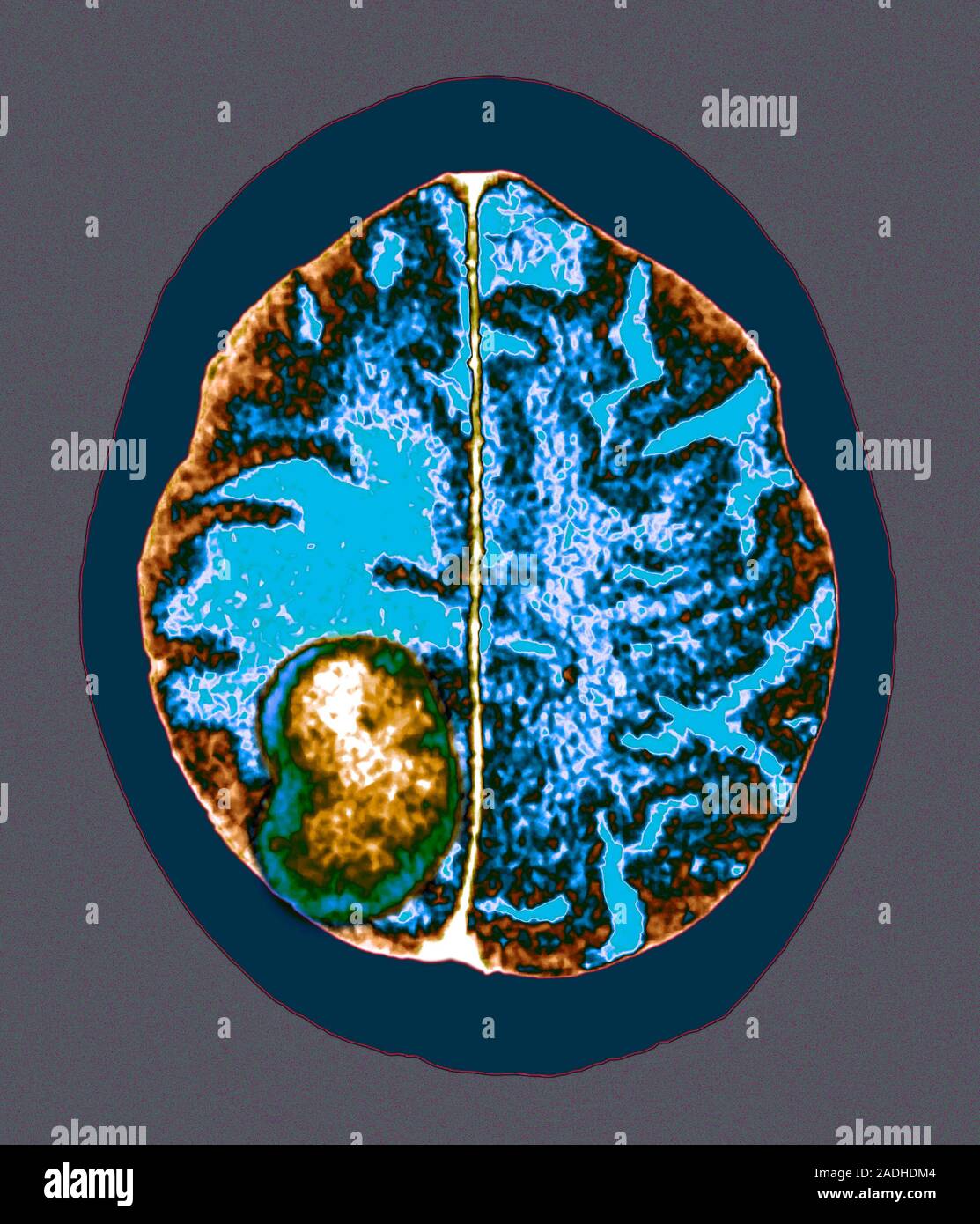 Secondary brain cancer. Coloured computed tomography (CT) scan passing horizontally (axially ...