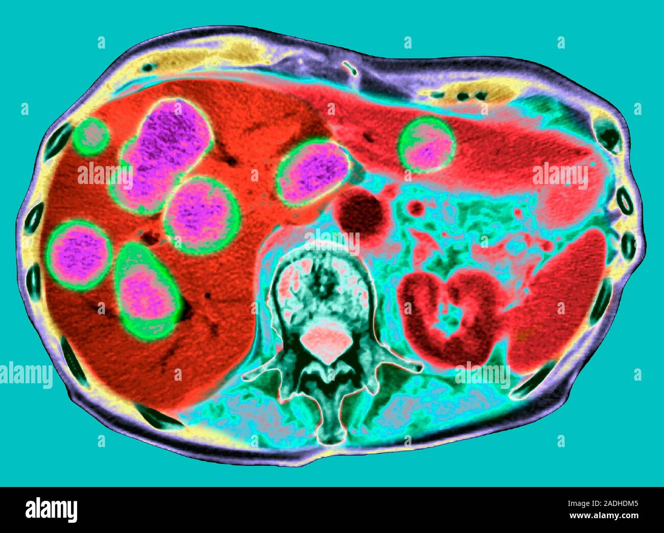 Secondary liver cancer. Coloured computed tomography (CT) scan of numerous tumours (purple and ...