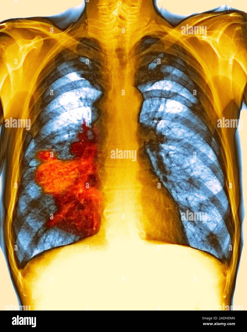 Lung cancer. Coloured chest X-ray showing a large tumour (red) due to ...
