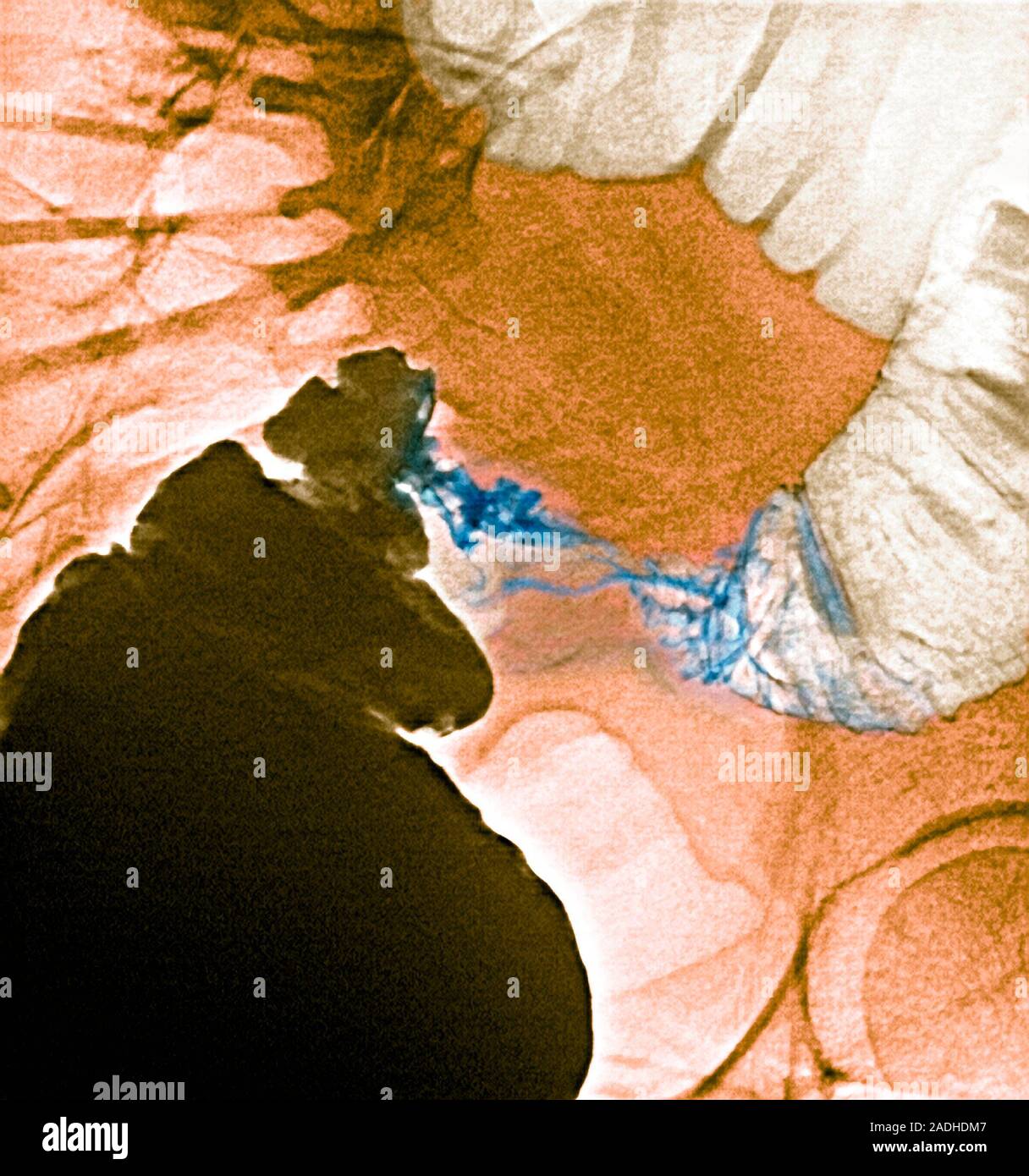 Colon cancer. Coloured X-ray of colon cancer revealed by a barium enema ...