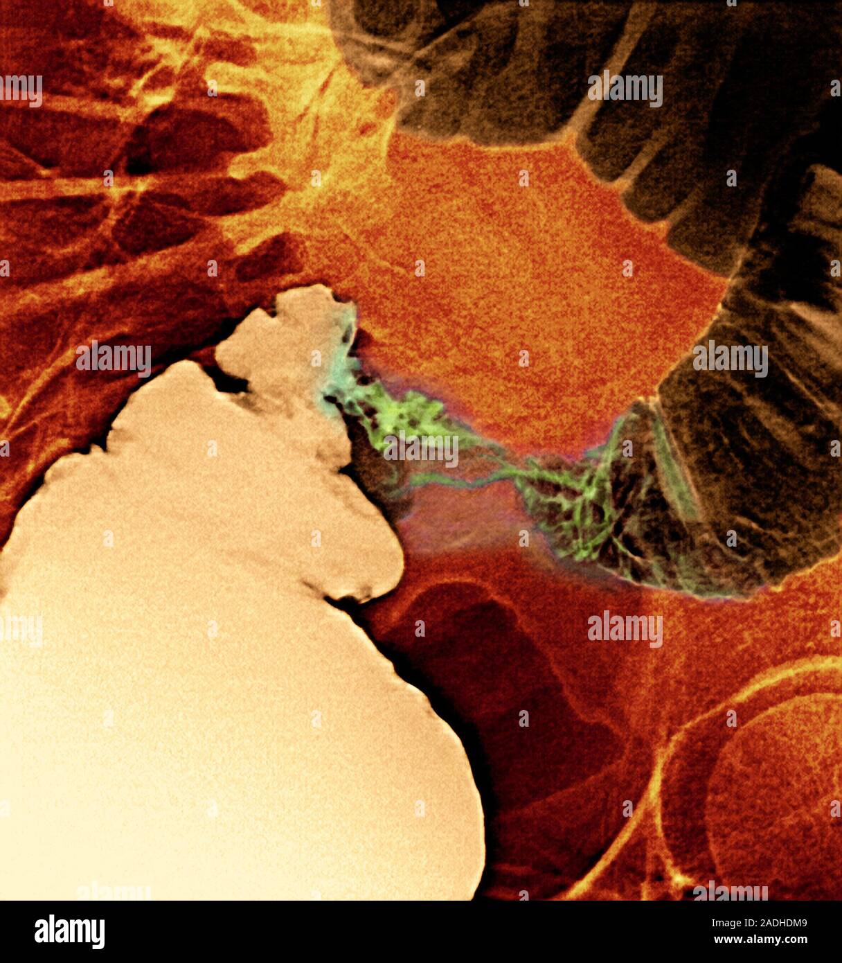 Colon cancer. Coloured X-ray of colon cancer revealed by a barium enema ...