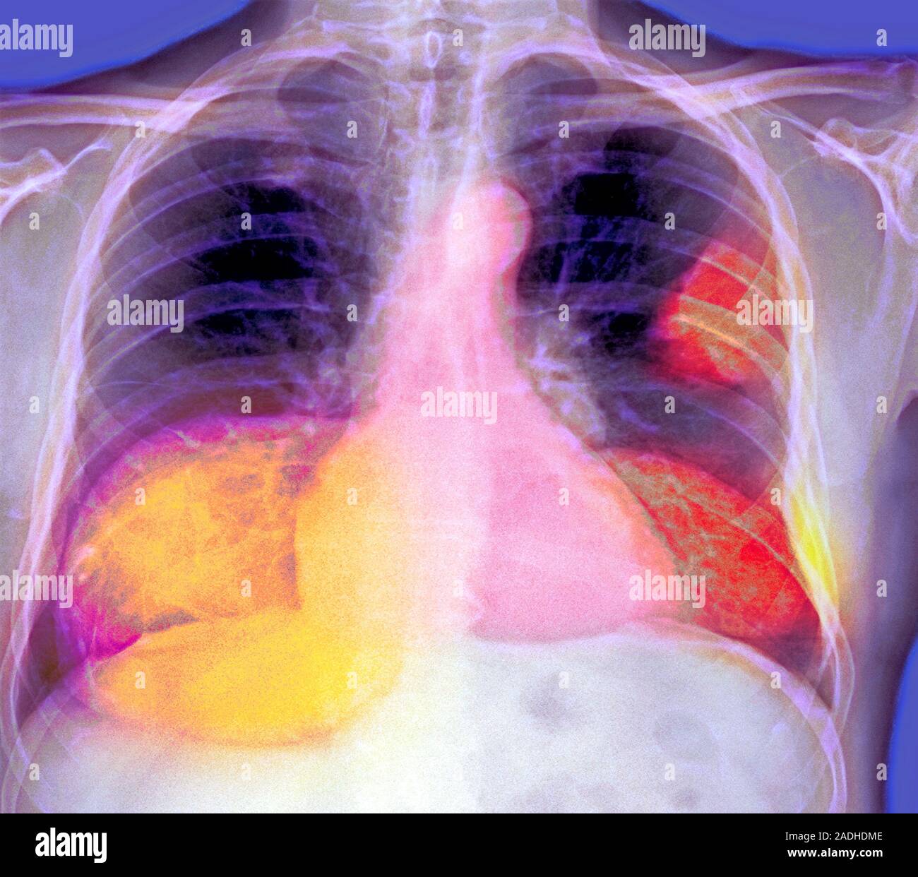 Secondary lung cancer. Coloured X-ray of metastases (secondary cancers ...