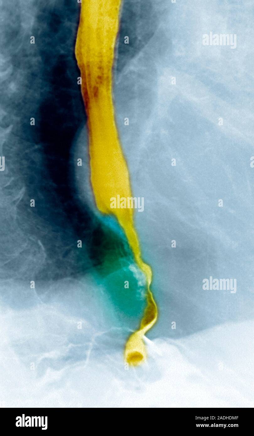 Oesophageal cancer. Coloured X-ray of a tumour (blue-green, lower ...
