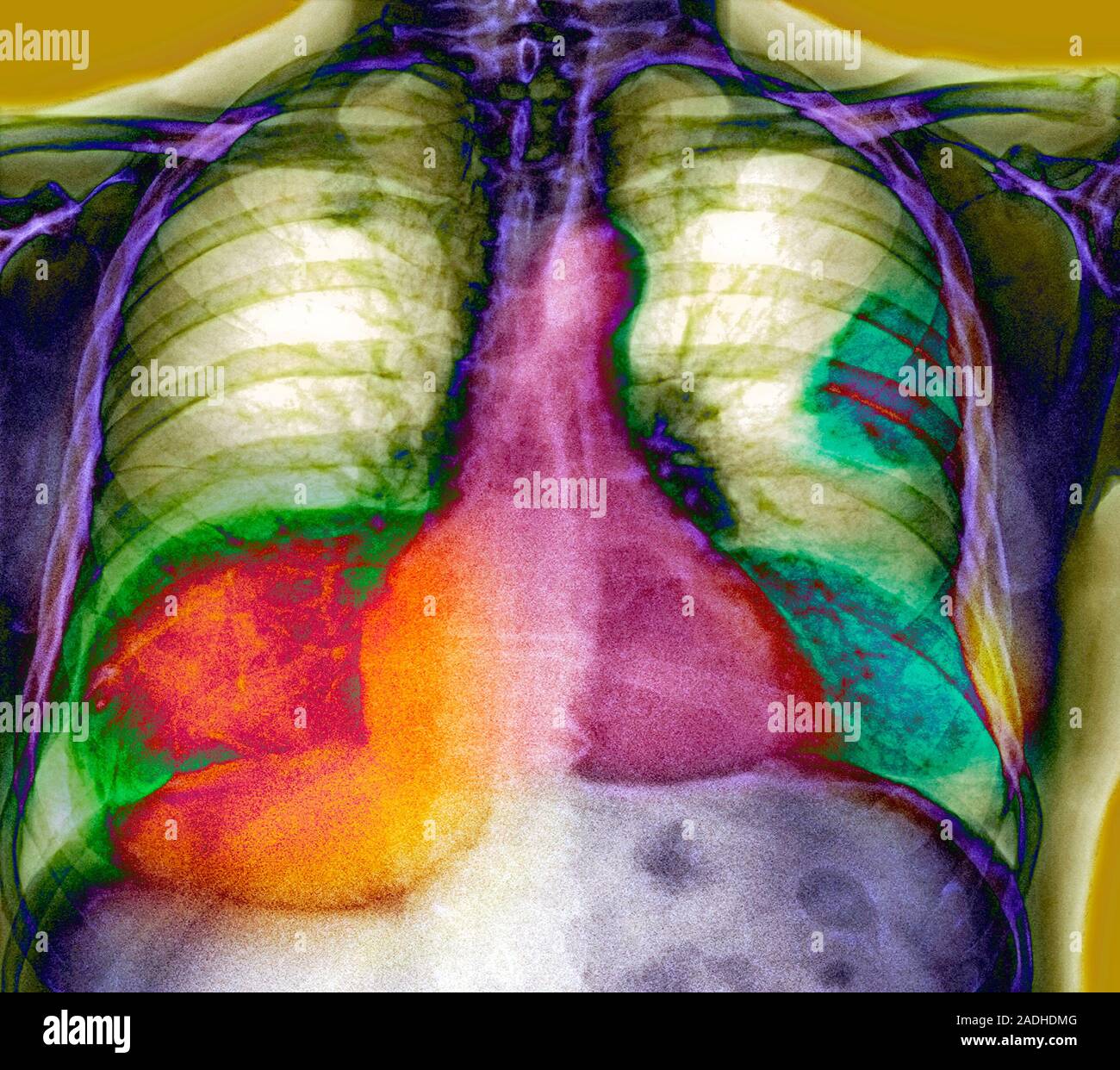 Secondary lung cancer. Coloured X-ray of metastases (secondary cancers ...