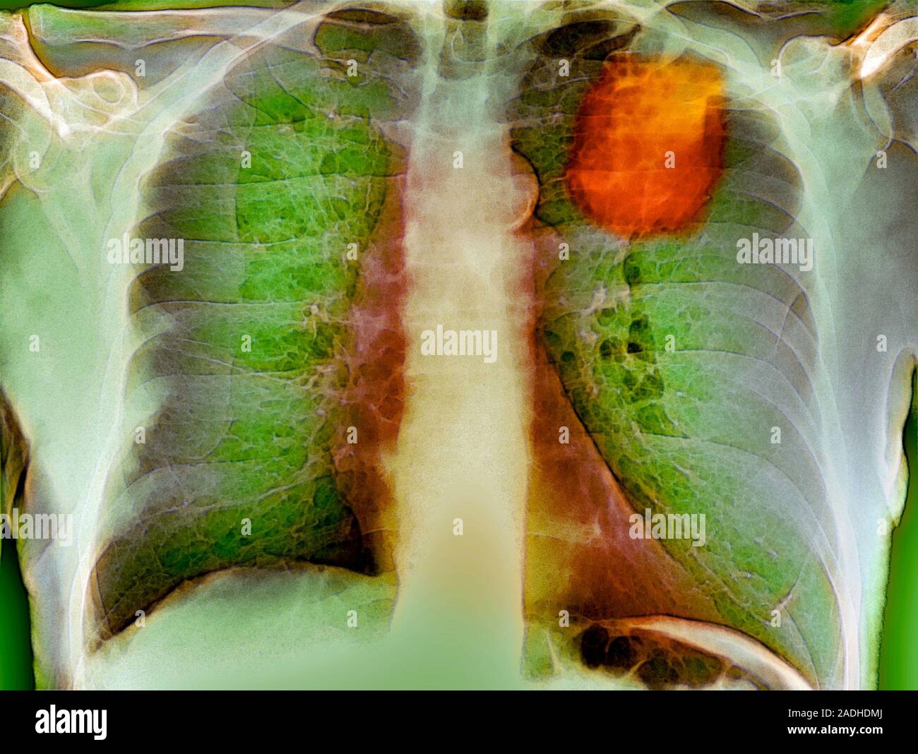 Lung cancer. Coloured frontal chest X-ray of a large lung cancer tumour ...