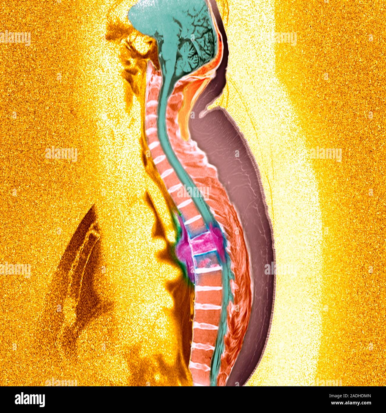Bone cancer. Coloured sagittal (side) magnetic resonance imaging (MRI ...