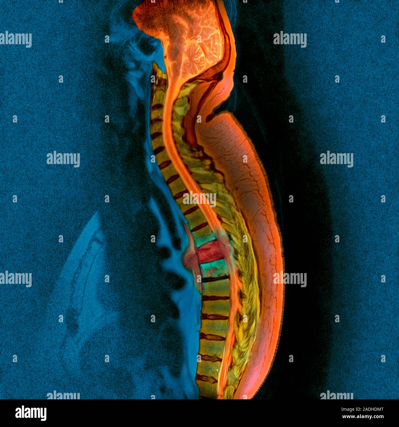 Bone cancer. Coloured sagittal (side) magnetic resonance imaging (MRI ...