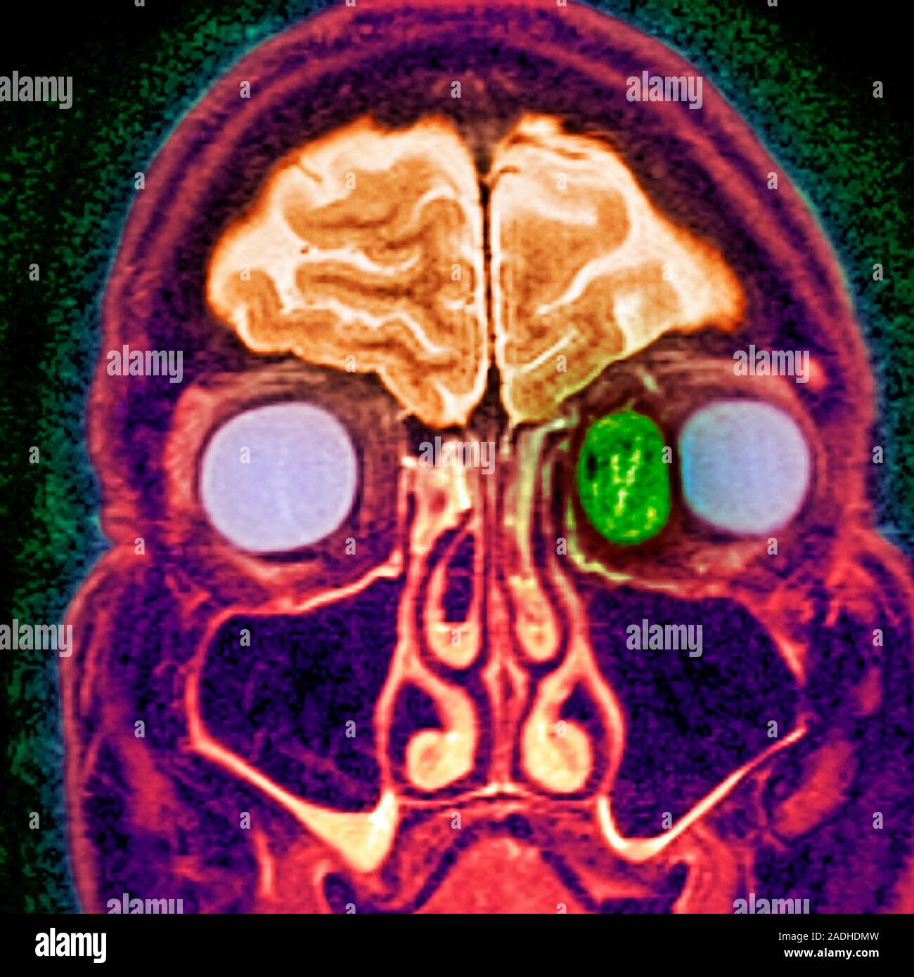 Secondary cancer. Coloured magnetic resonance imaging (MRI) scan of a ...