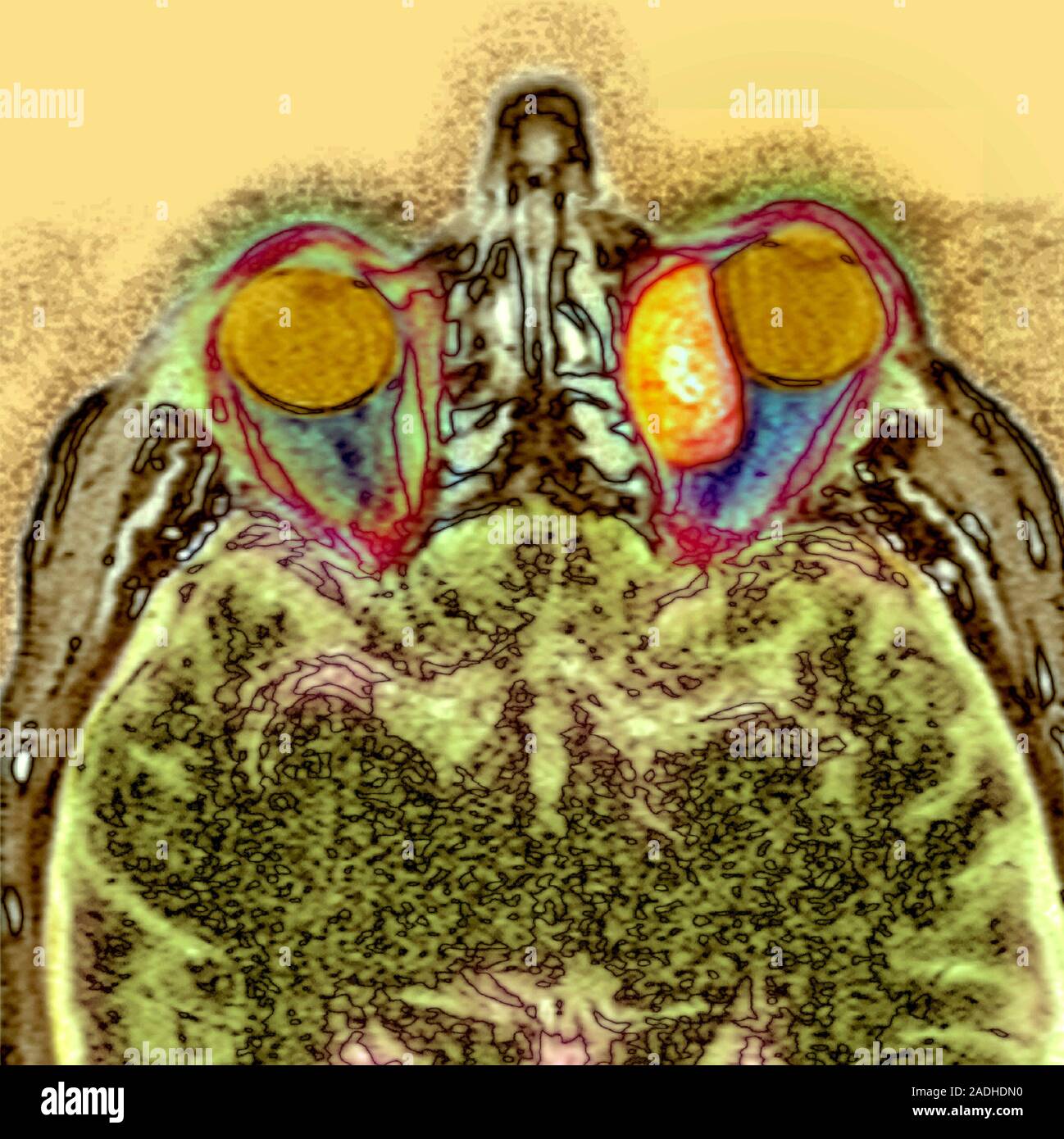 Secondary cancer. Coloured magnetic resonance imaging (MRI) scan of an ...