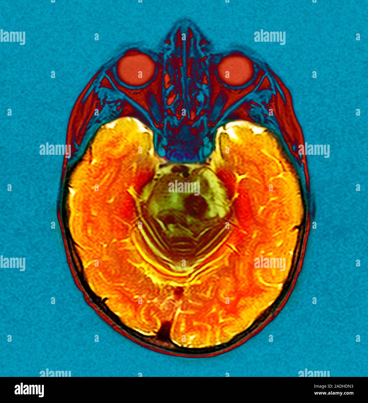 Brain cancer. Coloured magnetic resonance imaging (MRI) scan of an axial section through the ...