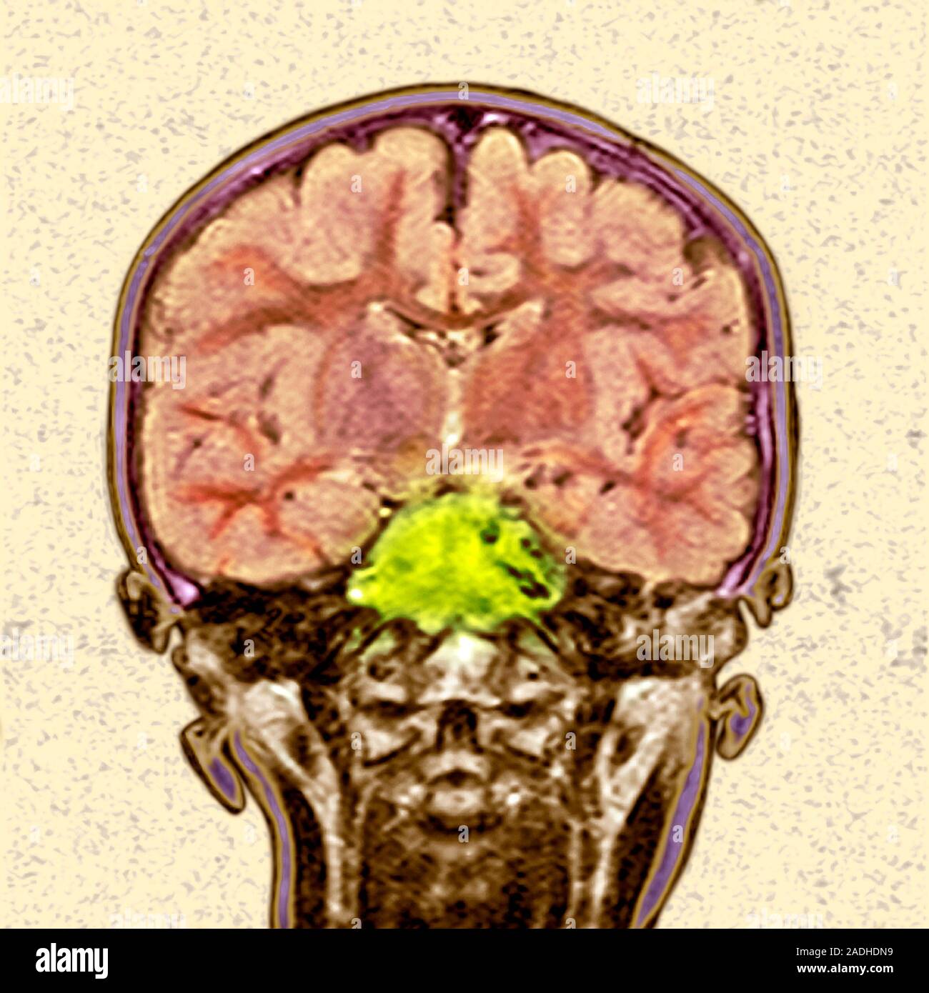 Brain cancer. Coloured magnetic resonance imaging (MRI) scan of a ...