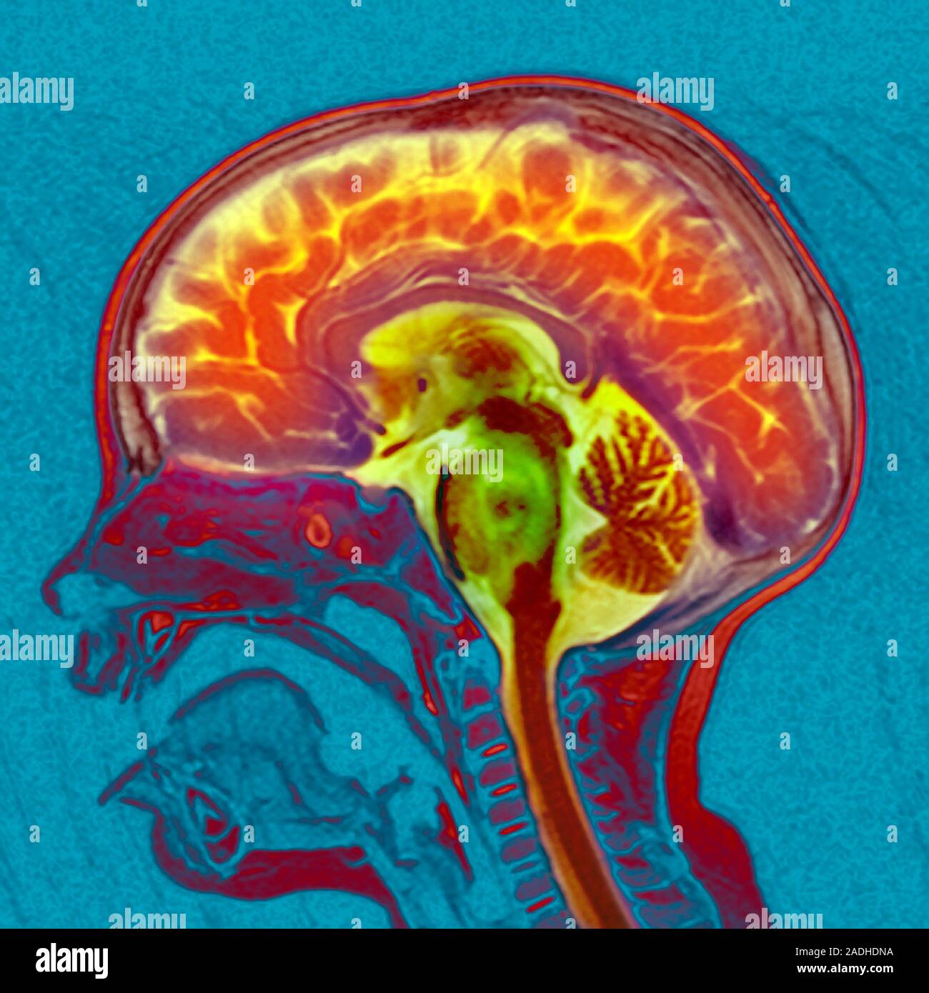Brain cancer. Coloured magnetic resonance imaging (MRI) scan of a sagittal (side) section ...
