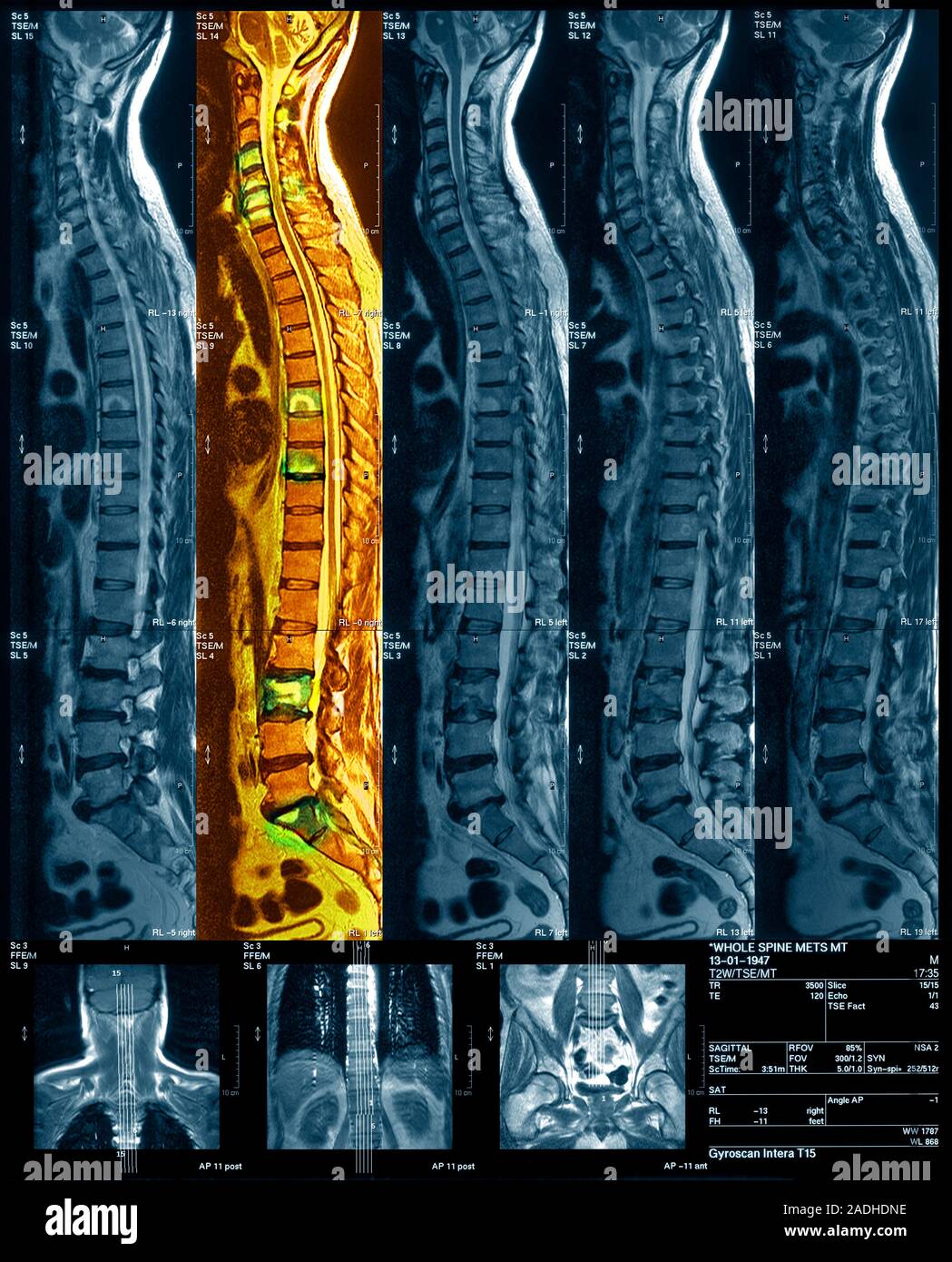 Bone cancer. Coloured magnetic resonance imaging (MRI) scan of a ...