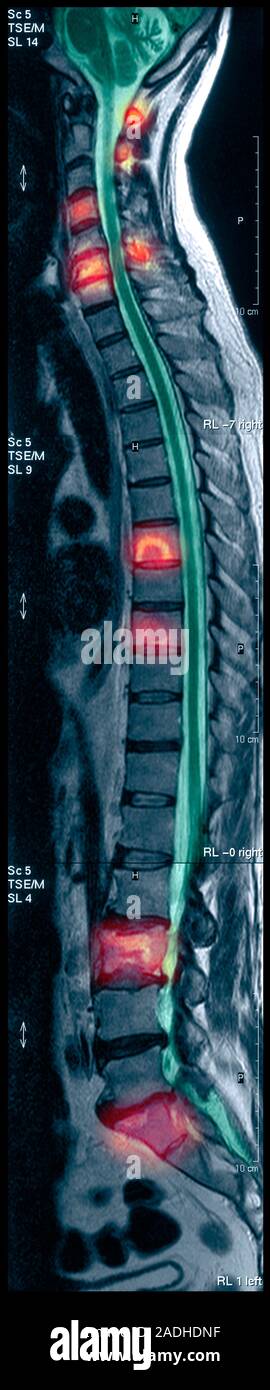 Bone cancer. Coloured magnetic resonance imaging (MRI) scan of a ...