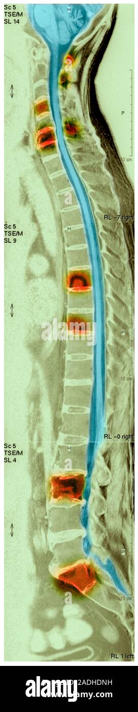 Bone cancer. Coloured magnetic resonance imaging (MRI) scan of a ...