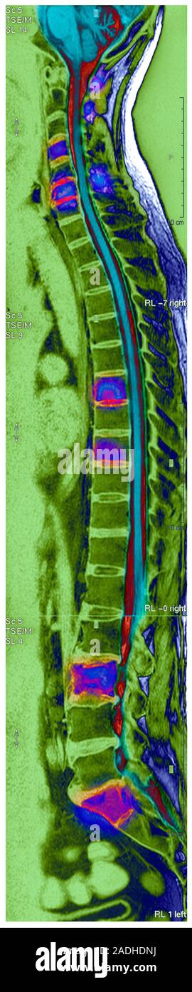 Bone cancer. Coloured magnetic resonance imaging (MRI) scan of a ...